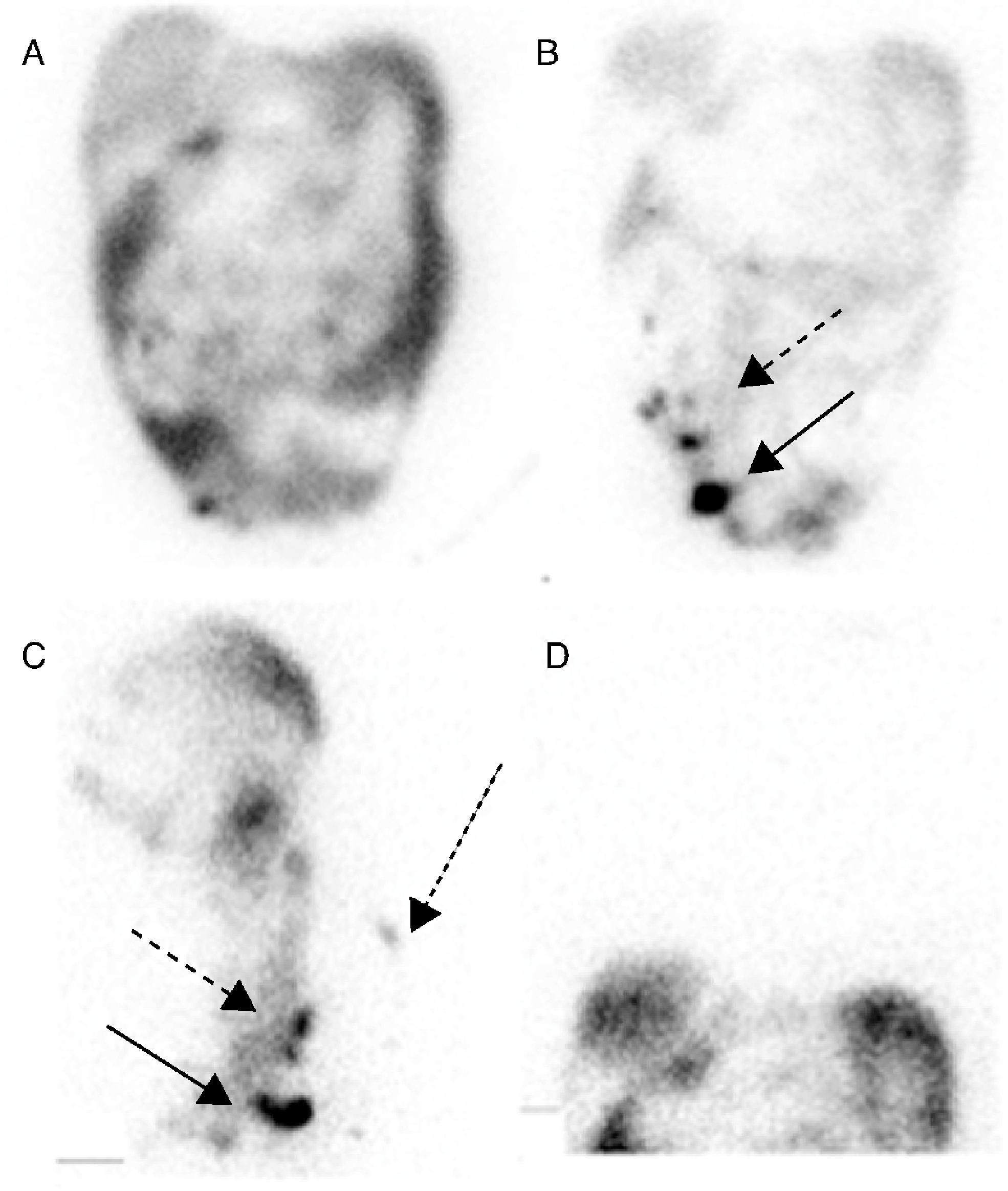 Utility of SPECT-CT in the identification of fistulas in a peritoneal ...