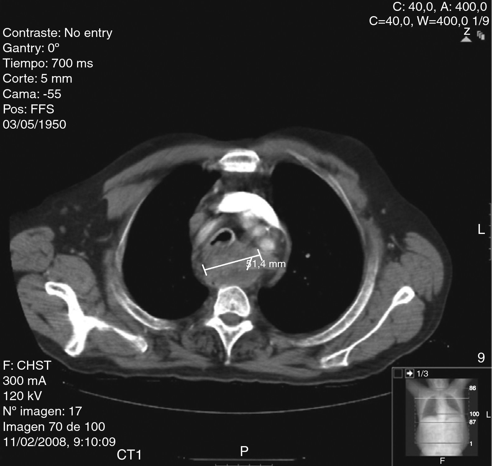 Contribution of V/Q lung scan to the diagnosis of esophageal carcinoma ...