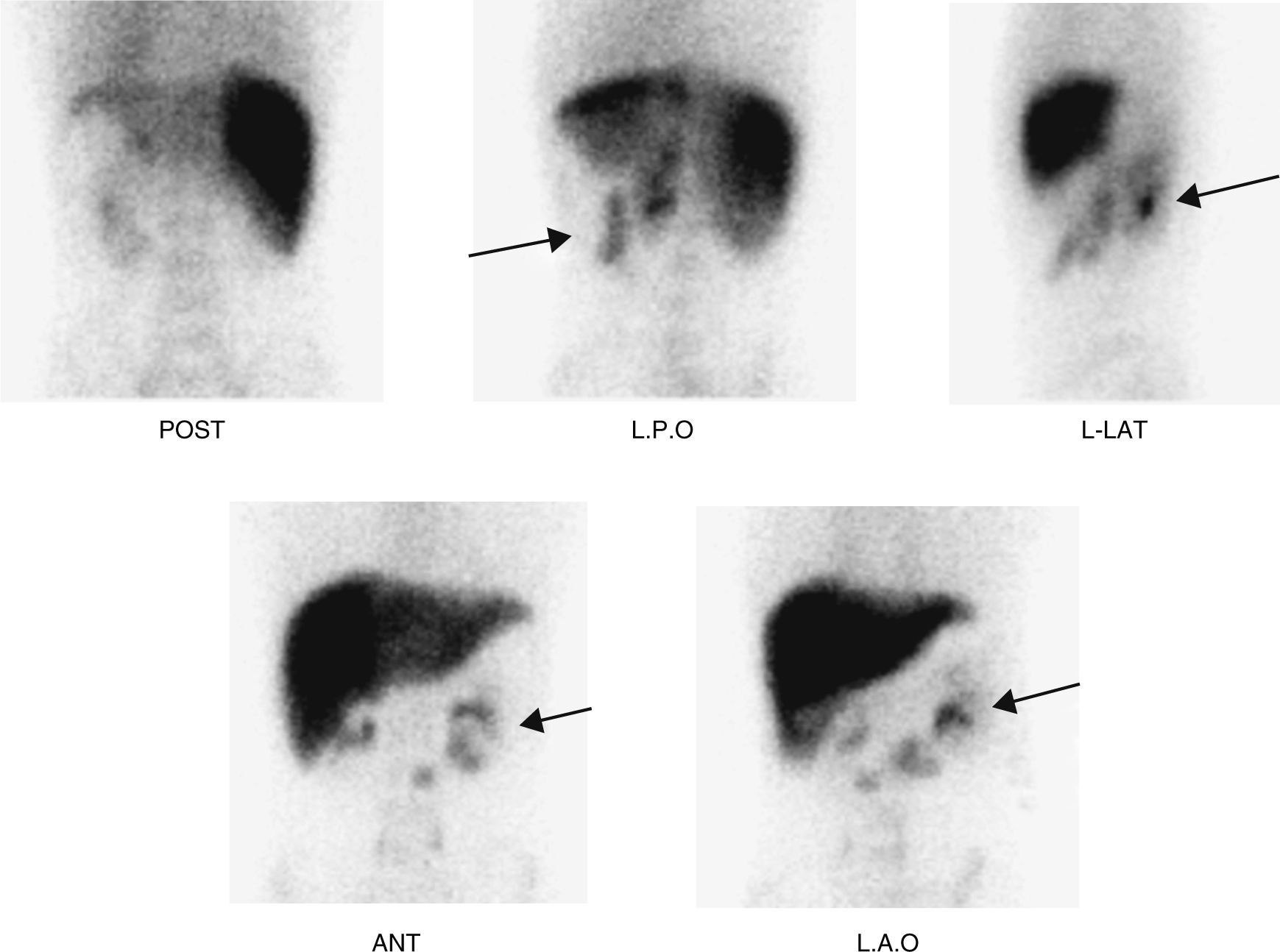 Application of 99mTc-denatured red blood cells scintigraphy in the ...