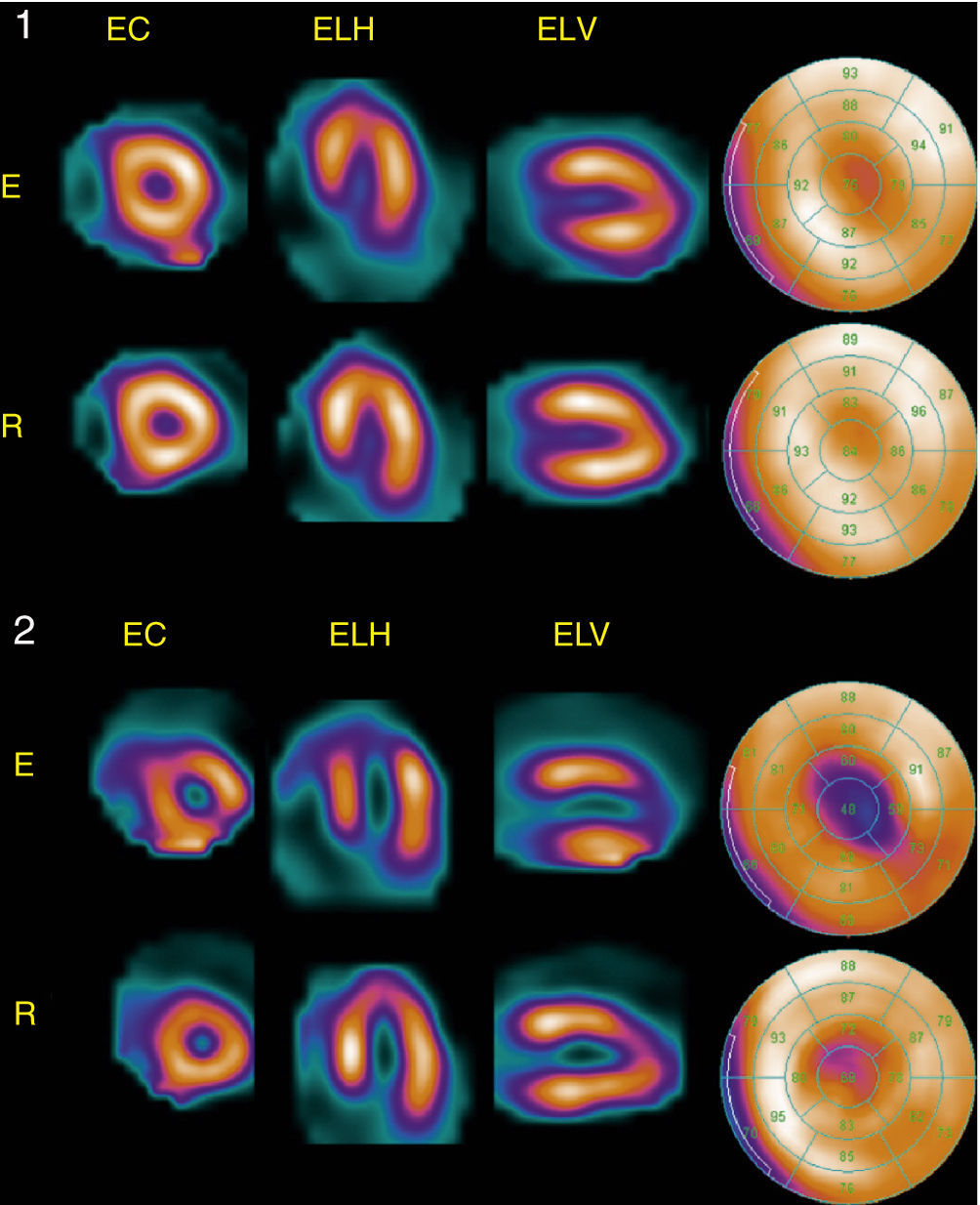 Variables that influence the indication of a second myocardial ...