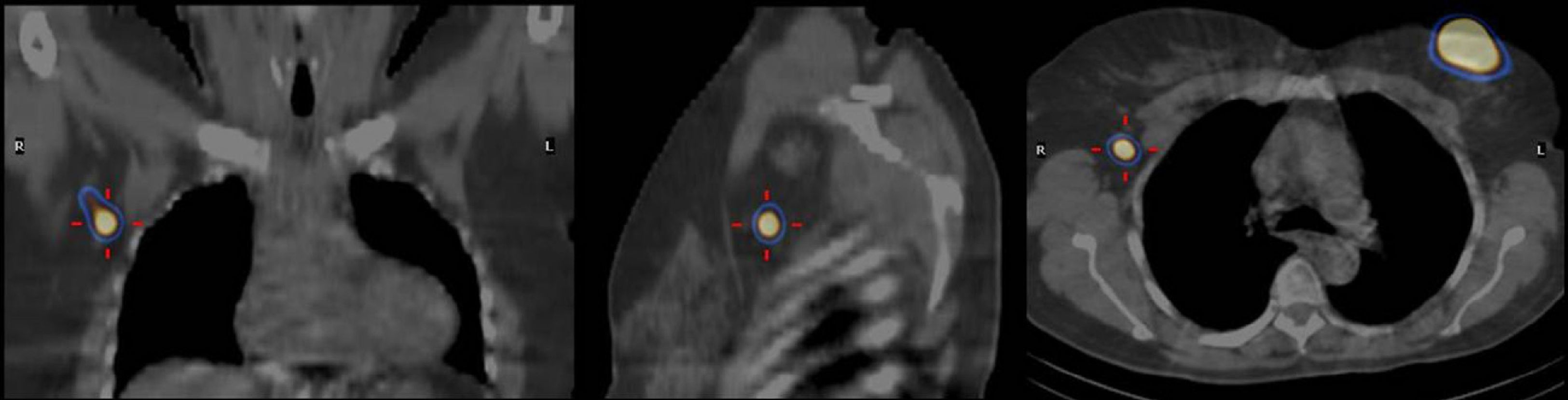 Selective sentinel node biopsy in breast cancer with contralateral ...