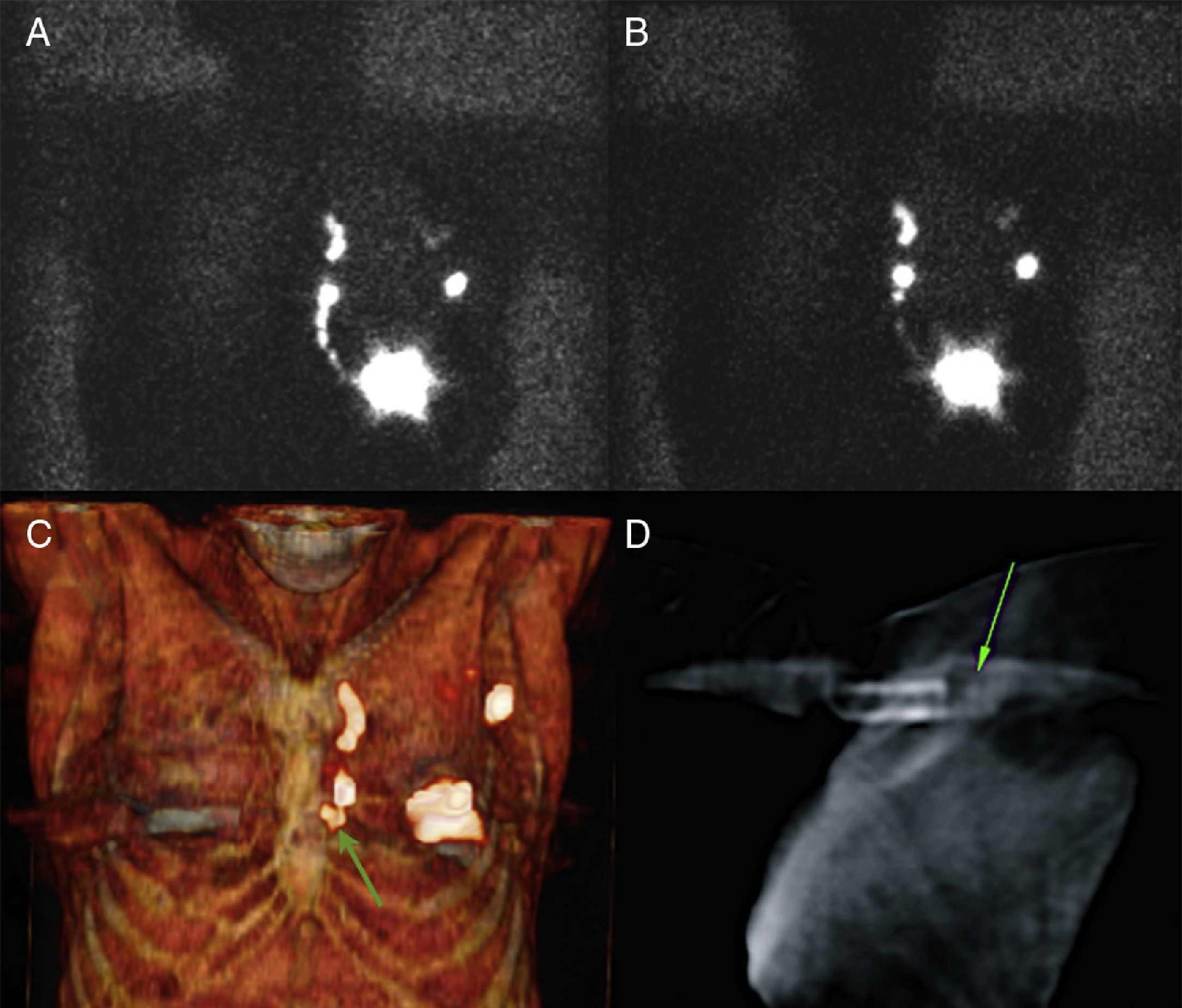 Sentinel node in melanoma and breast cancer. Current considerations ...