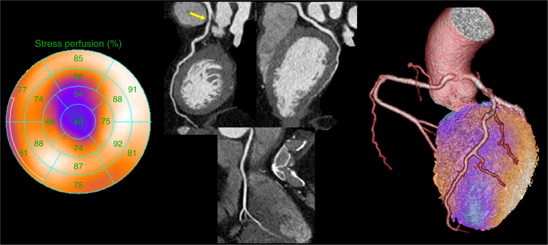 SPECT, coronary angio-CT, invasive coronary angiography and fusion ...
