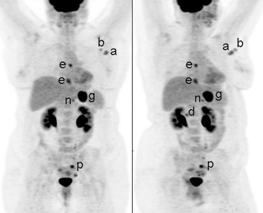 Carney's triad with synchronous breast cancer: 18F-FDG PET/CT imaging ...