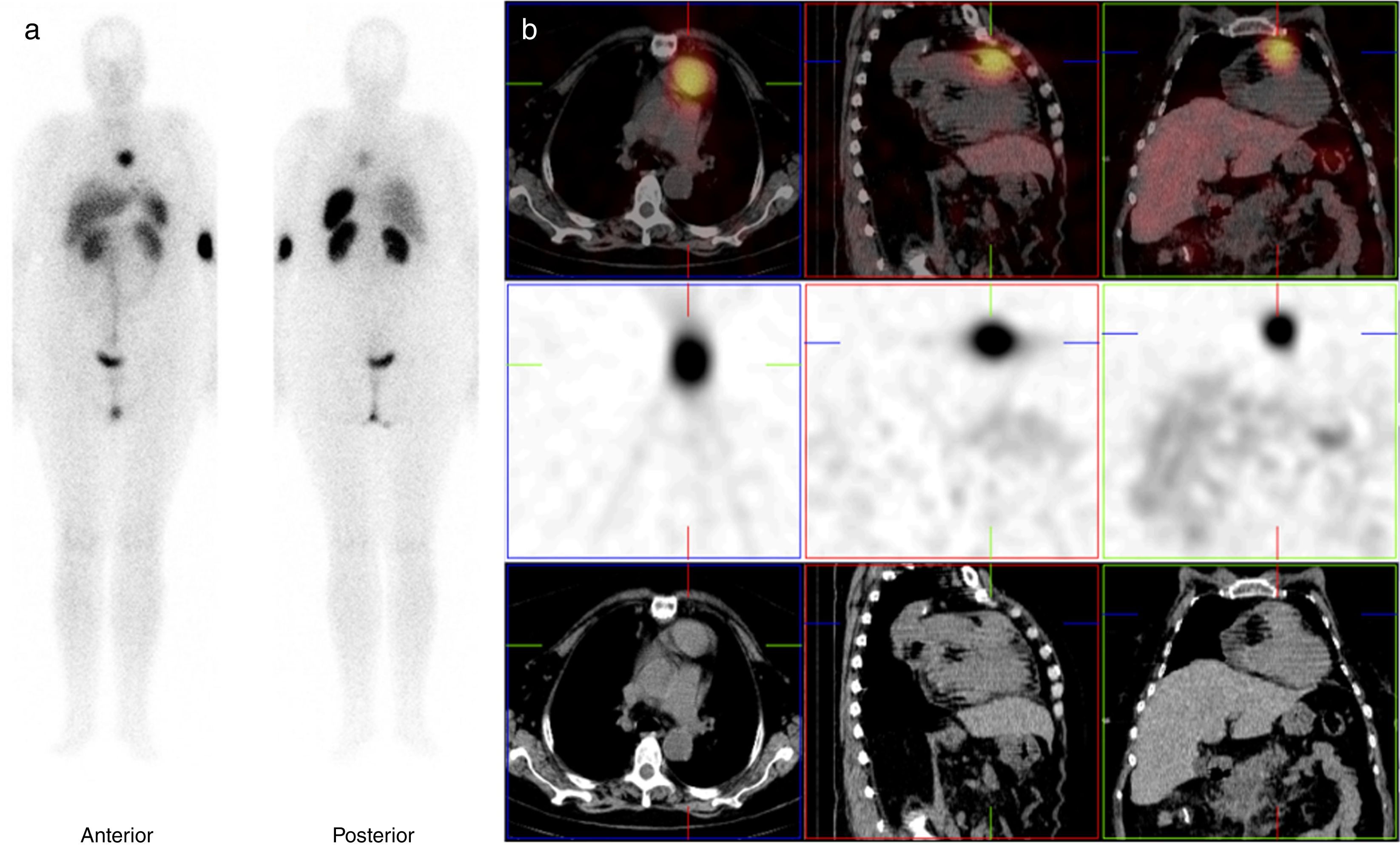 Pericardial metastases due to terminal ileum primary carcinoid tumour ...