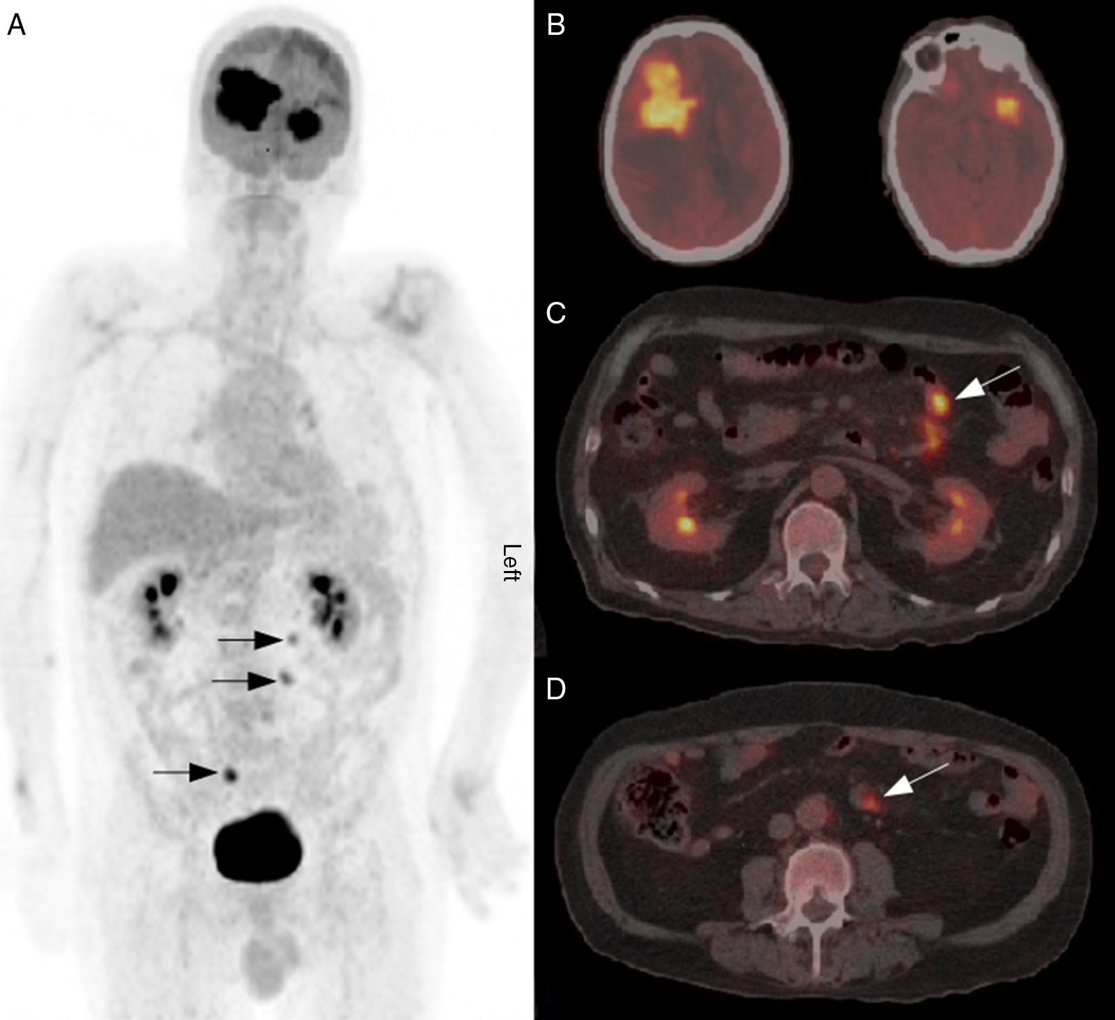 Role of 18F-FDG PET/CT in primary brain lymphoma | Revista Española de ...