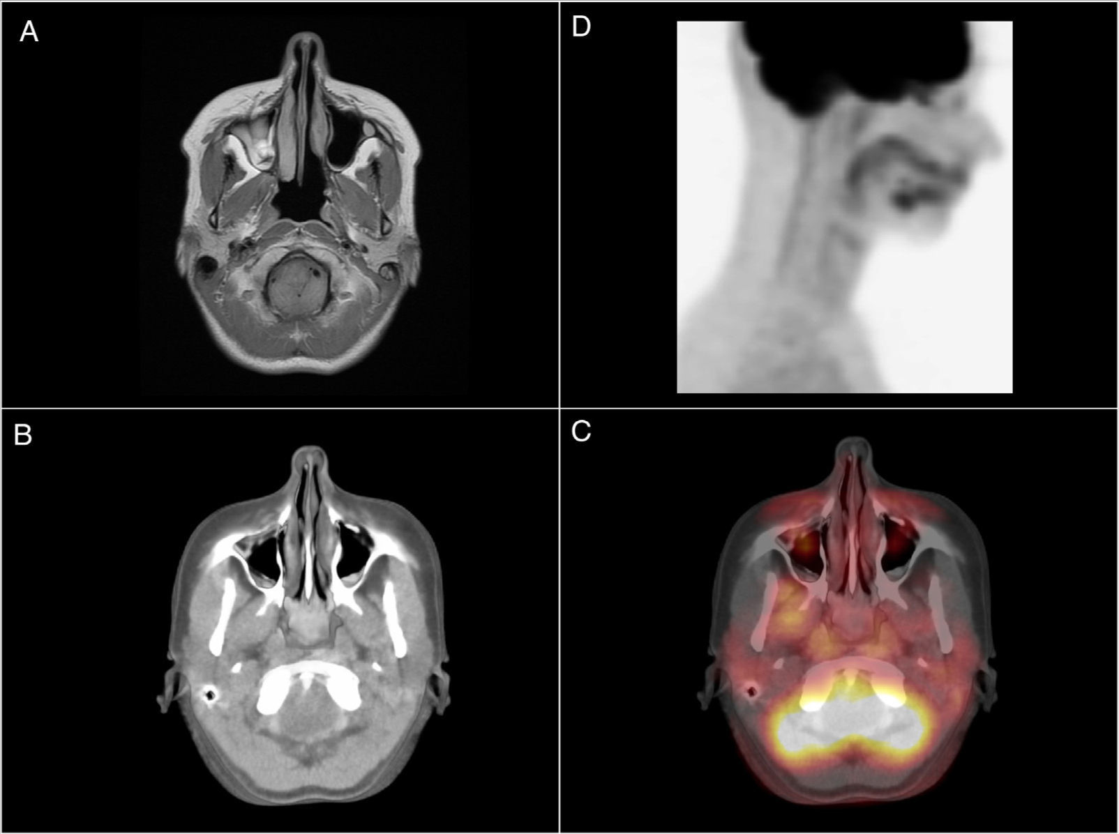 Inflammatory pseudotumour of the infratemporal fossa visualized with ...