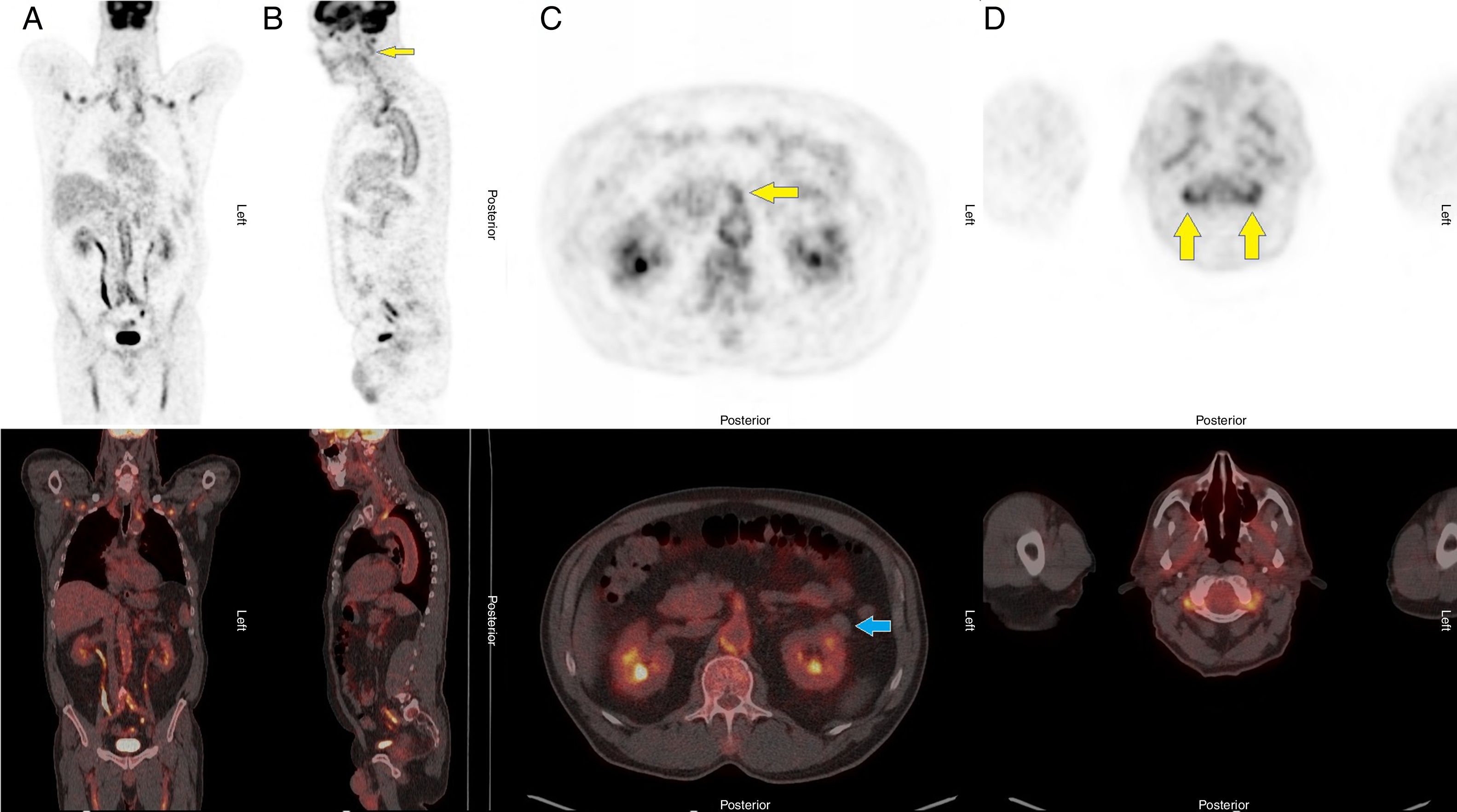Extensive large-vessel vasculitis diagnosed with 18F-FDG PET/CT ...