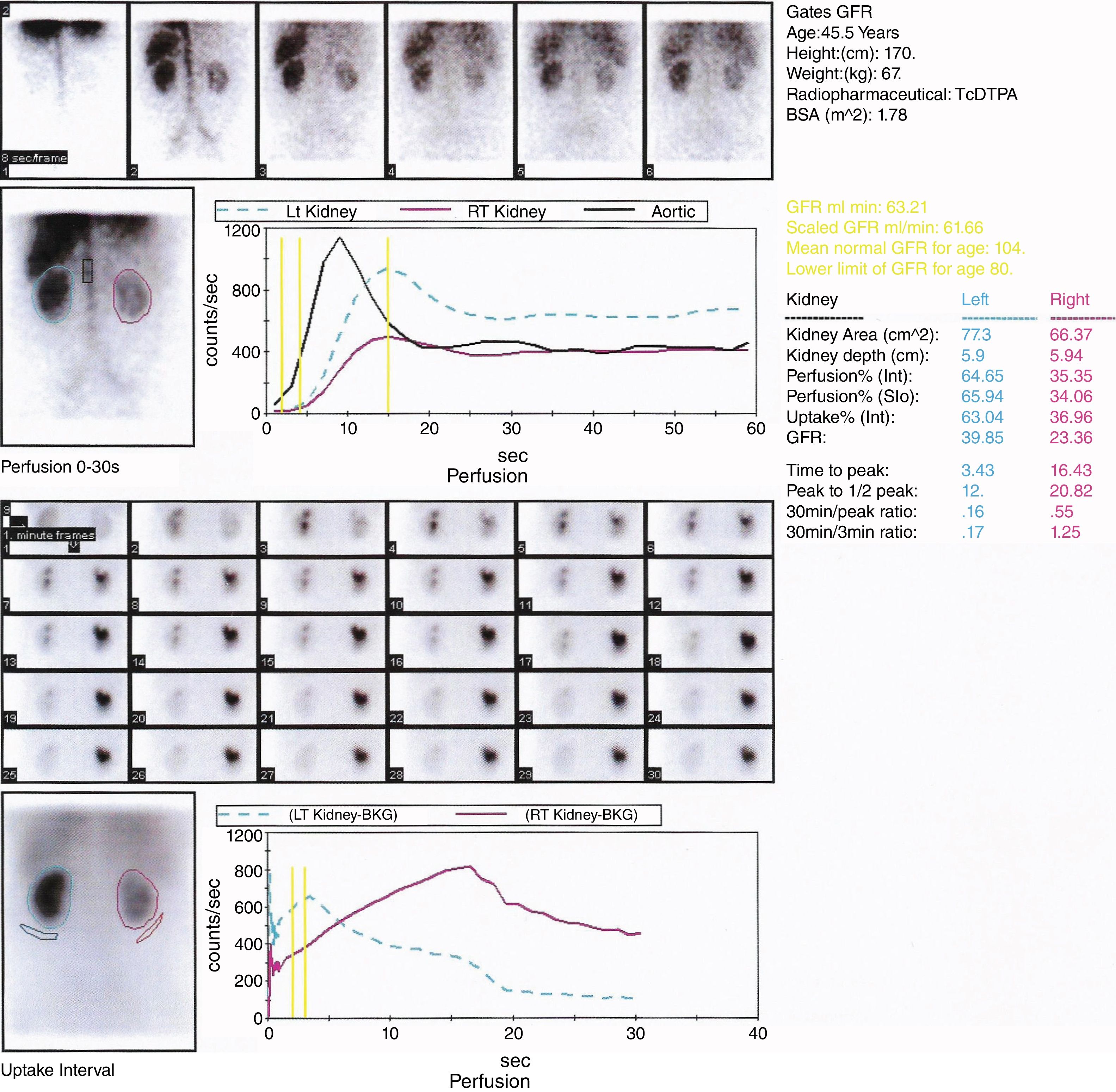 Visualization of a pyelocaliceal diverticulum with [99mTc] DTPA and ...