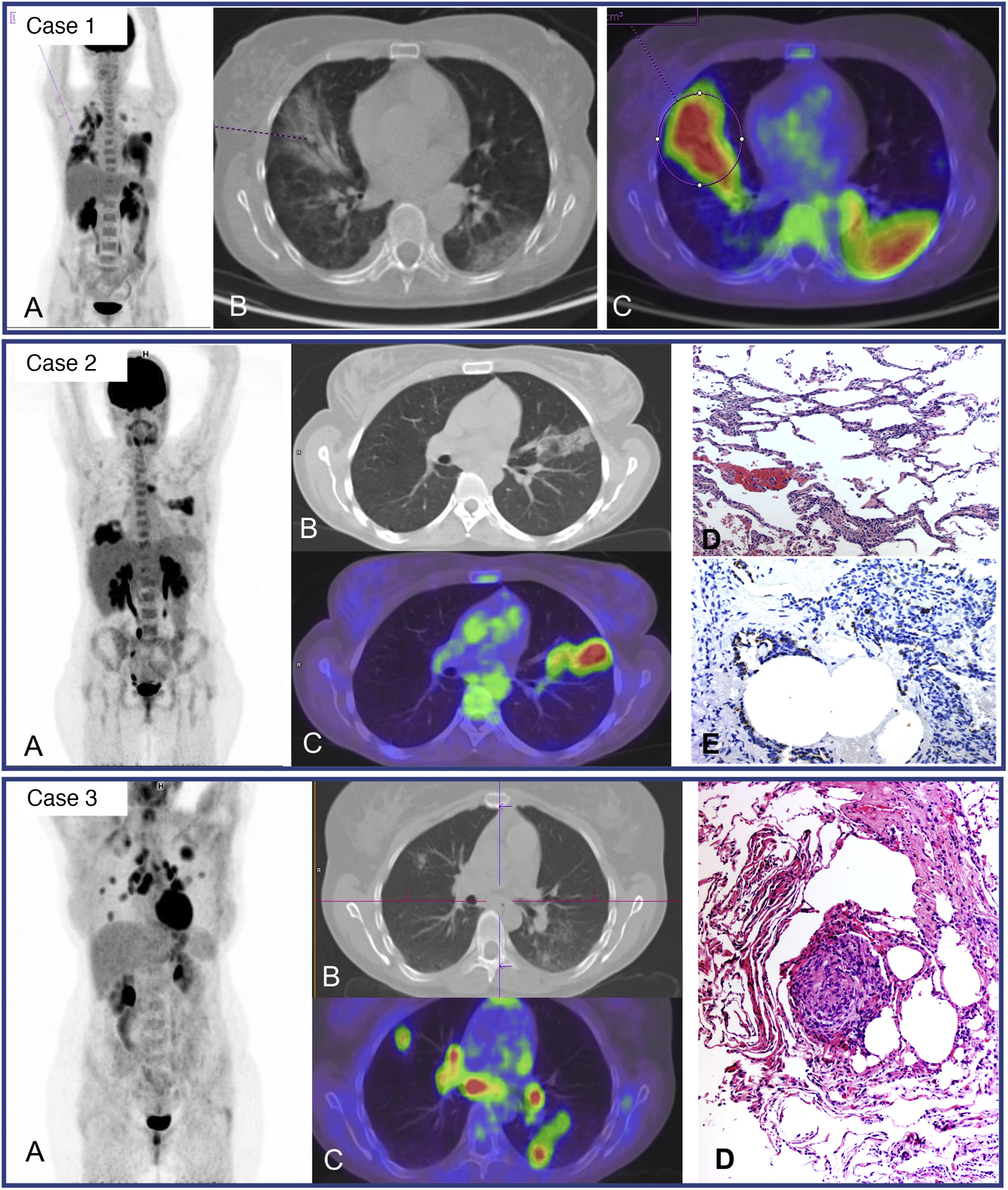 18F-FDG-PET/CT in SARS-CoV-2 infection and its sequelae | Revista ...