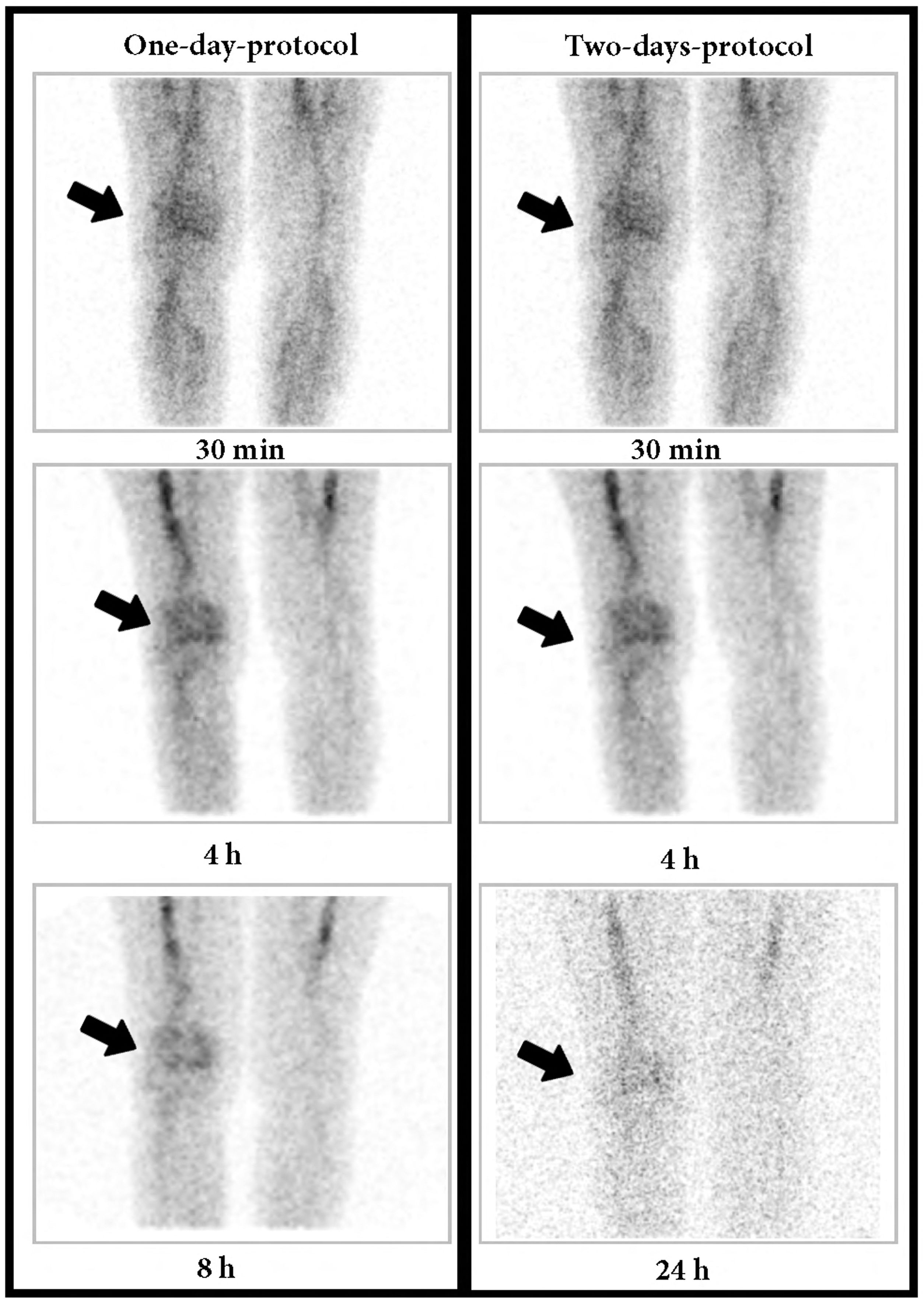 Diagnostic methodology in labelled leukocyte scan for prosthetic / non ...