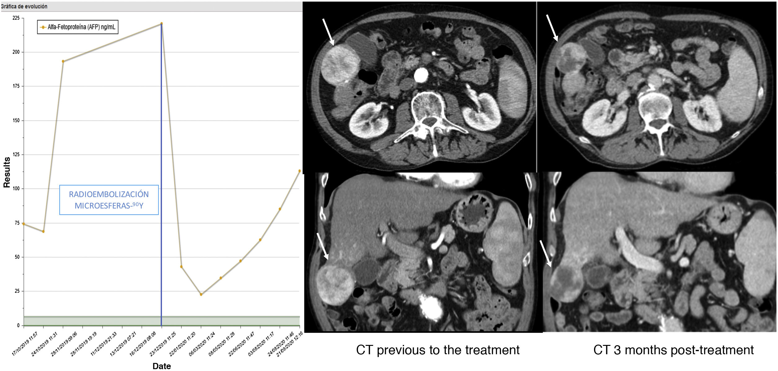 Radioembolisation with 90Y radiolabelled microspheres of hepatic tumour ...