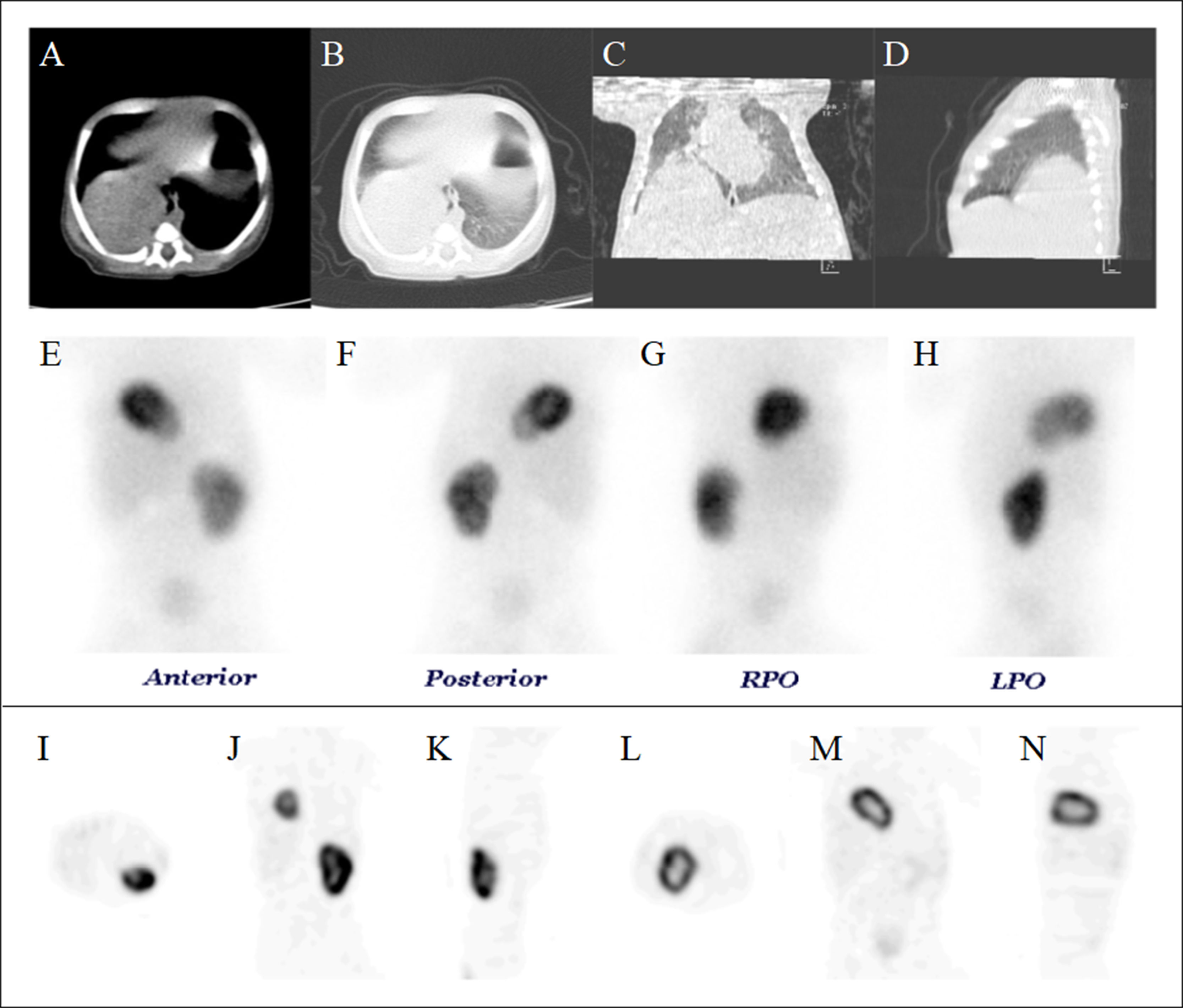 Rare finding of right ectopic thoracic kidney on 99mTc-DMSA scan ...
