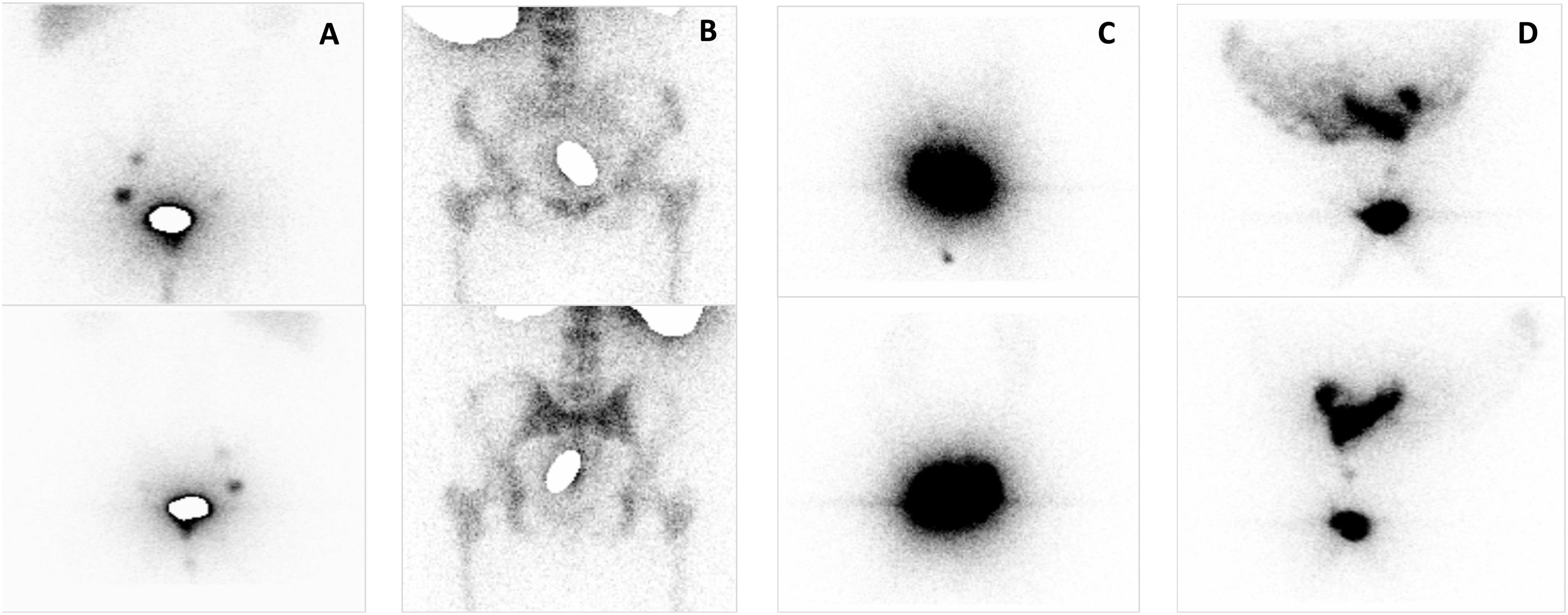 Failure of scintigraphy lymphatic mapping in endometrial cancer. Causes ...