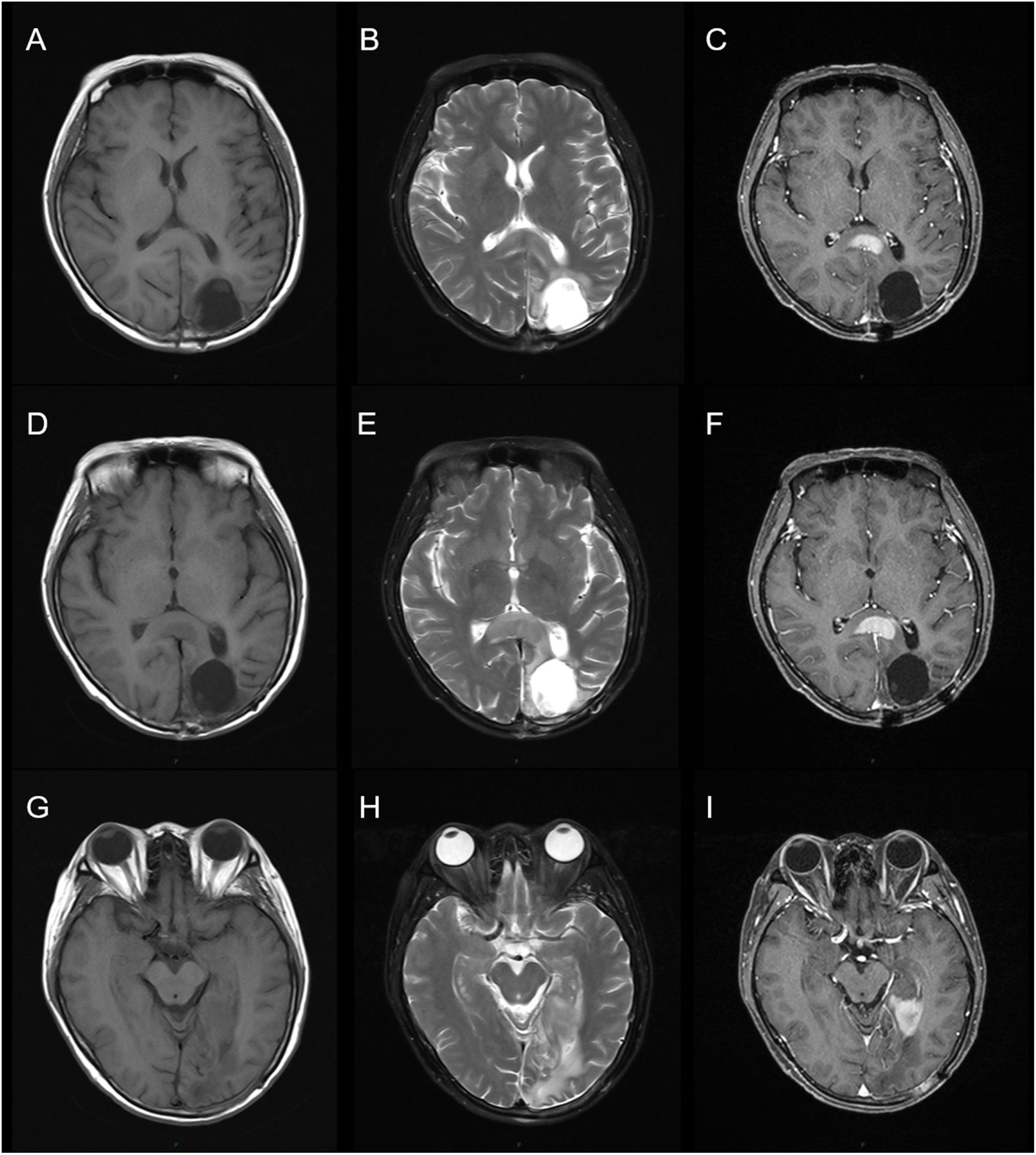 Diffuse large B-cell lymphoma detected by Al18F-NOTA-FAPI-04 PET/CT ...