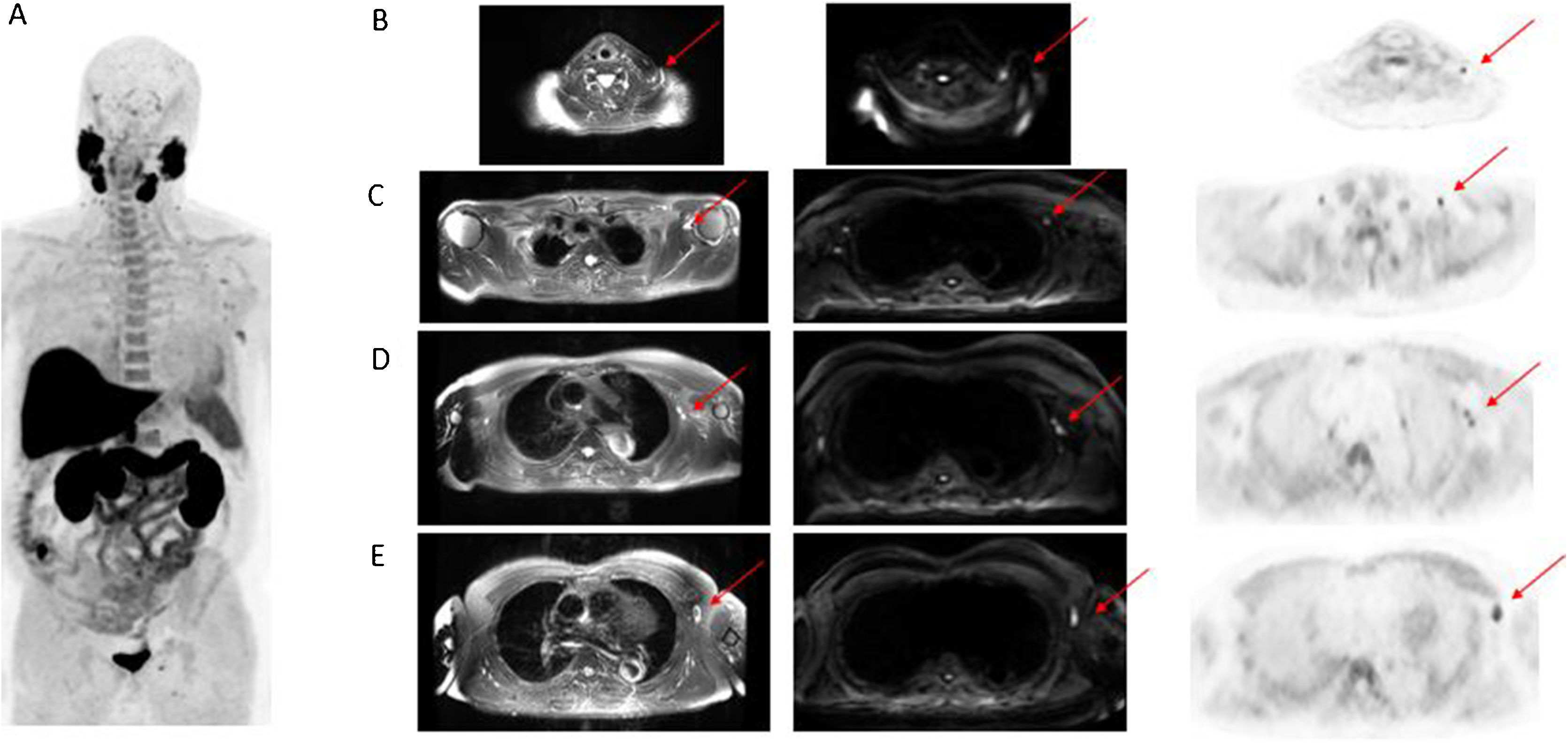 18F-Choline PET/MRI limphadenopathy related to SARS-CoV-2 vaccine ...
