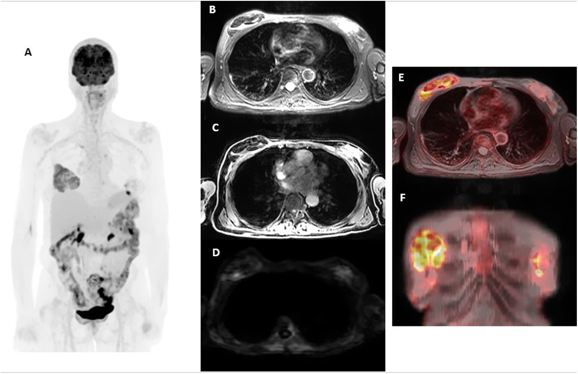 18F-FDG PET diagnosis of bilateral uniorganic IgG4-related mastitis ...
