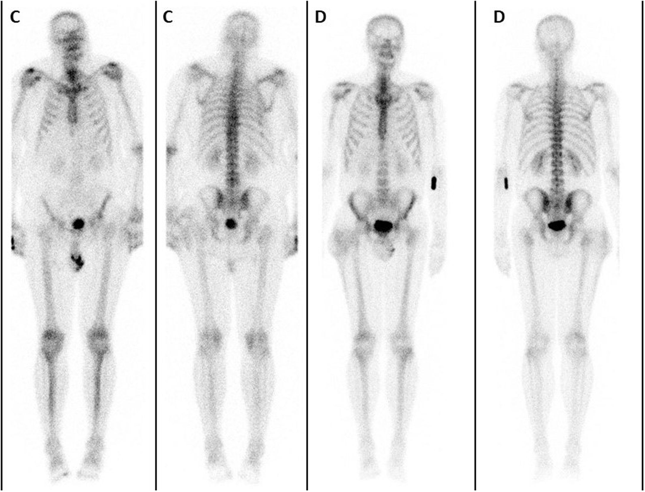 Utility of three-phase bone scintigraphy in malignancy assessment in ...