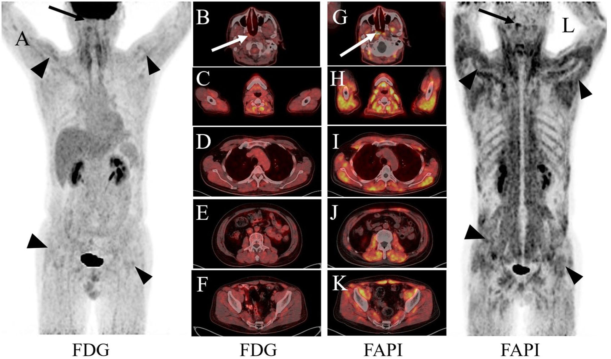 Detection of occult neoplasia in a patient with dermatomyositis using ...