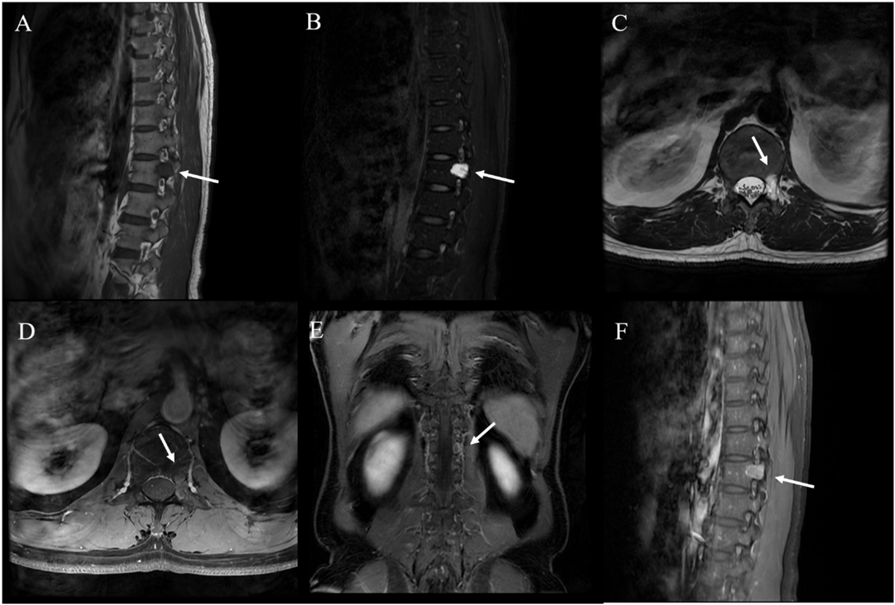 Imaging characteristics of an atypical spinal angiolipoma on PET/CT and ...