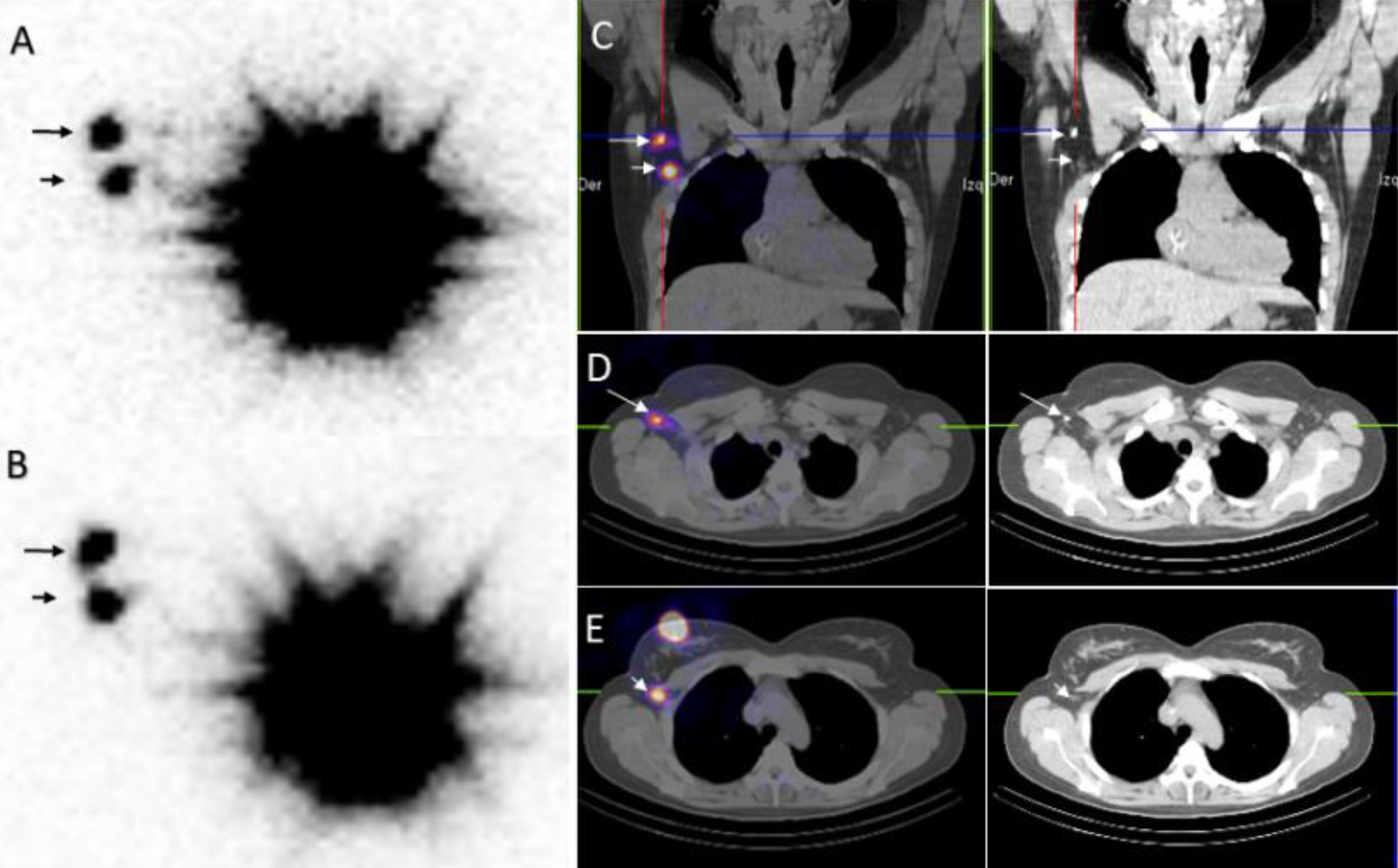 Revealing undetected axillary sentinel node in neoadjuvant chemotherapy ...