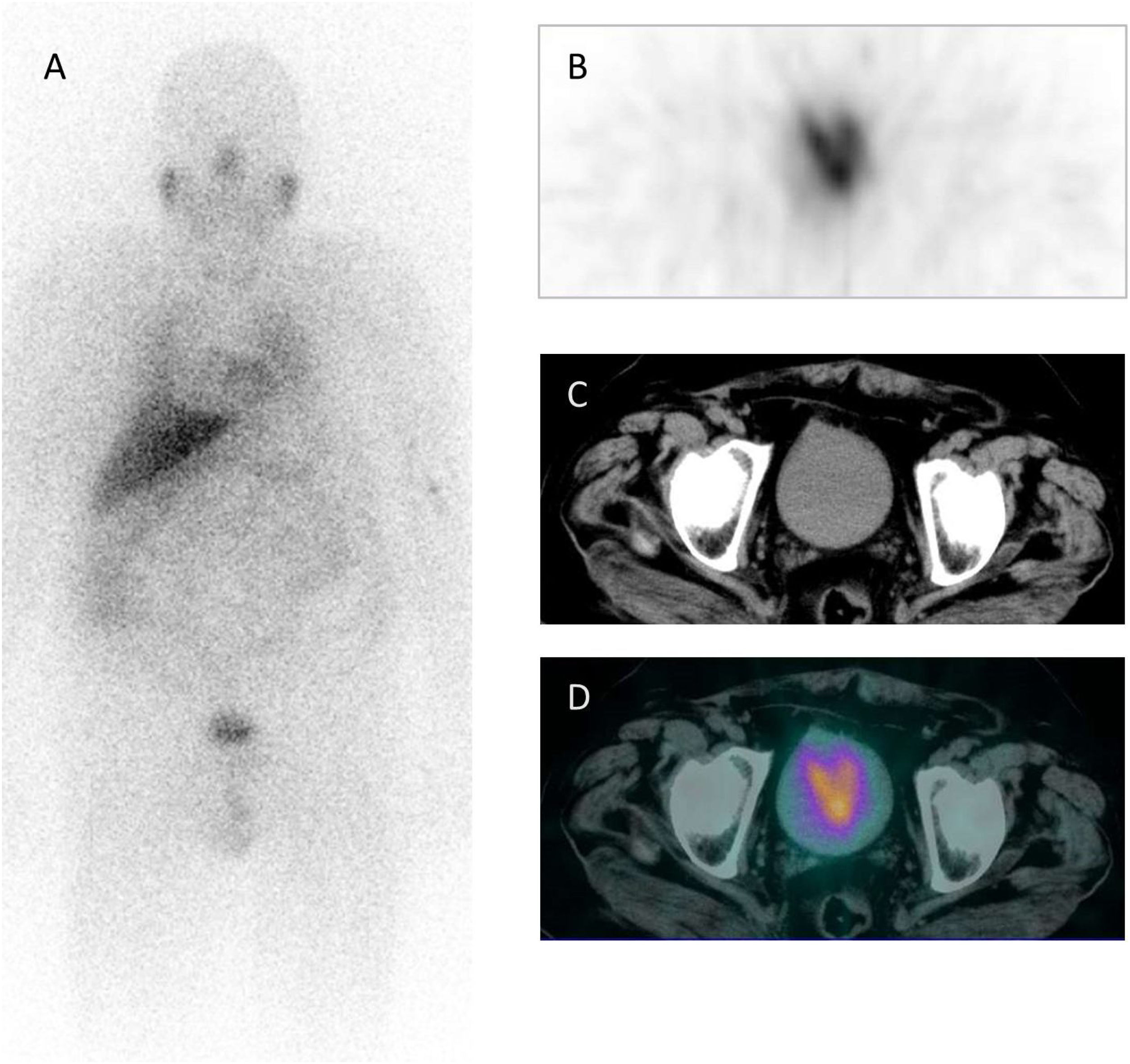 Incomplete resection in a rare case of bladder paraganglioma revealed ...