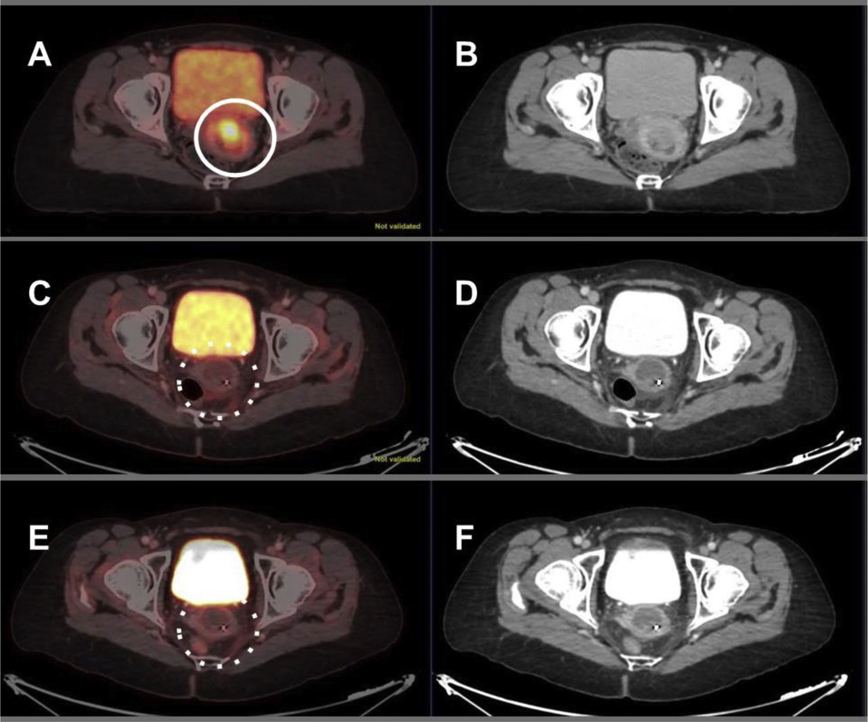 Use of propranolol in [18F] FDG-PET/CT for differential diagnosis of ...