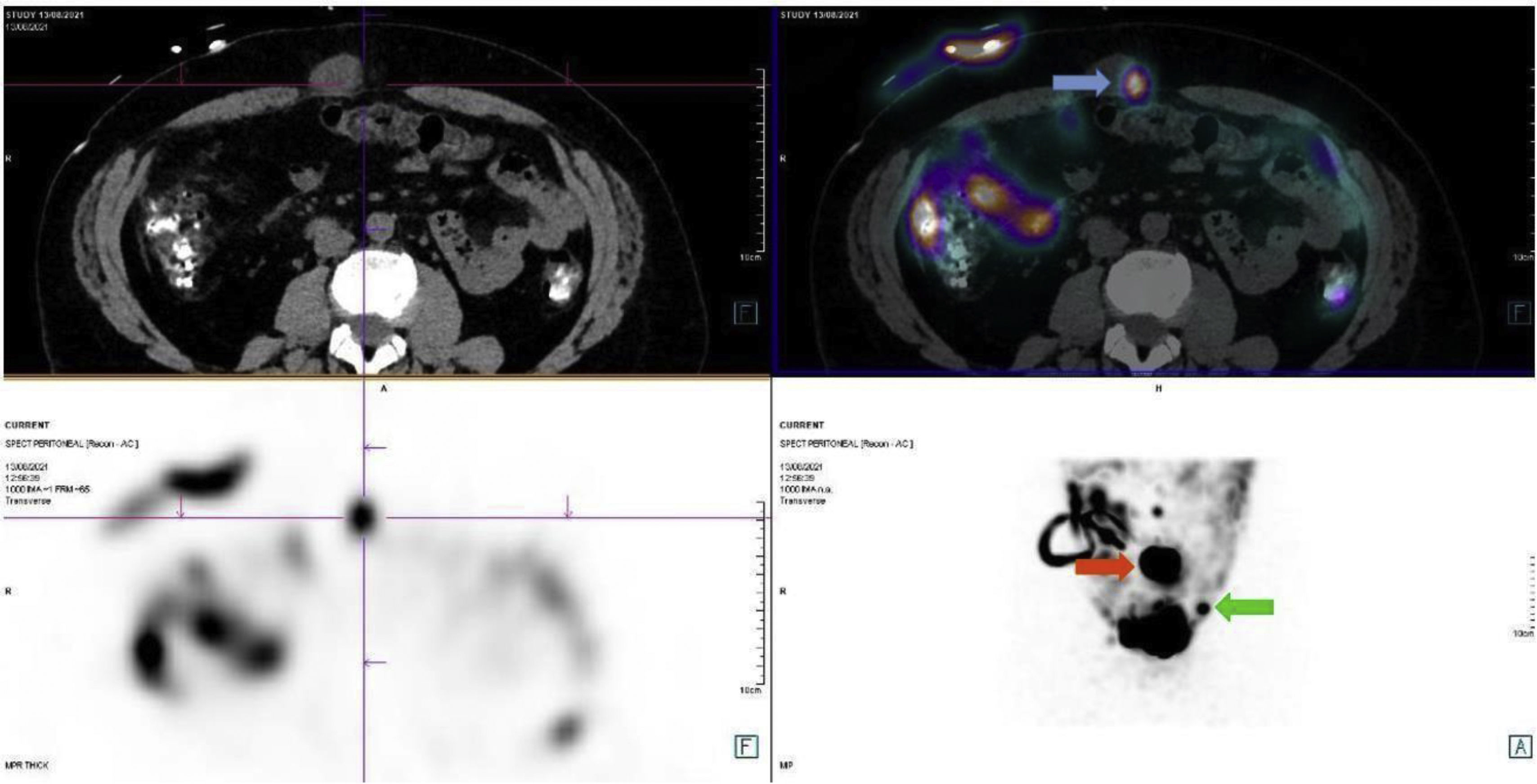 Peritoneal scintigraphy and SPECT/TC in the diagnosis of leaks in ...