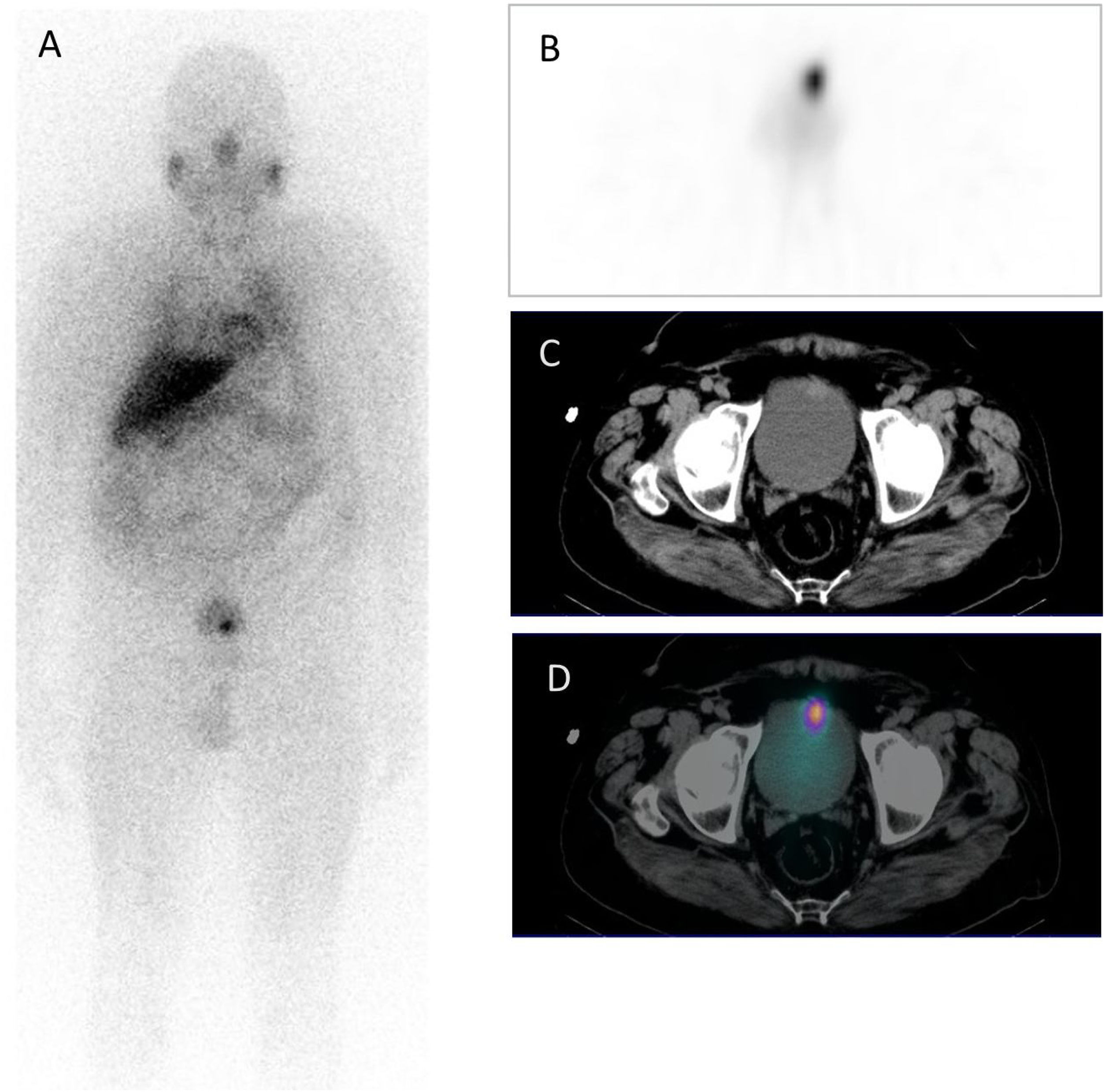 Incomplete resection in a rare case of bladder paraganglioma revealed ...