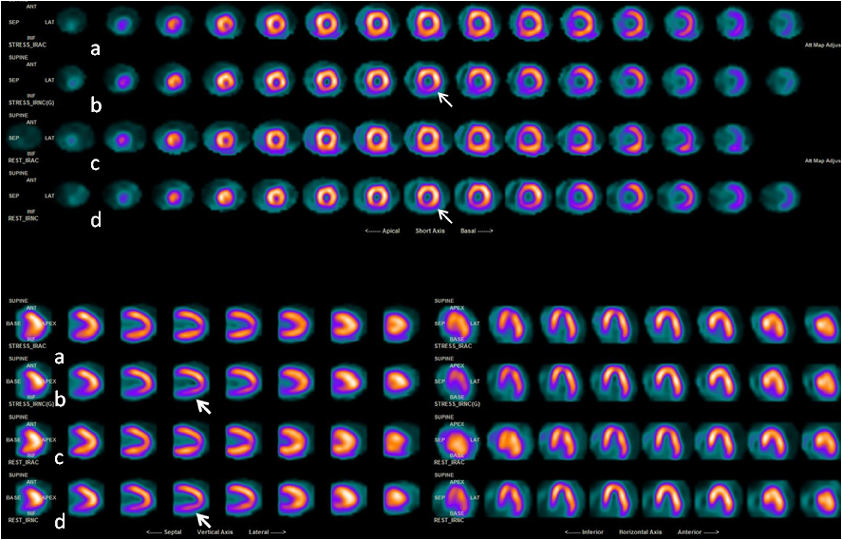Comparison of the diagnostic performances of CT attenuation corrected ...