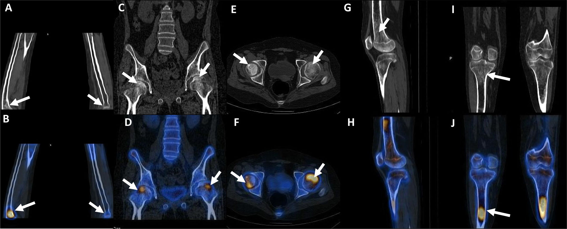 Multifocal osteonecrosis in pediatric-onset systemic lupus ...