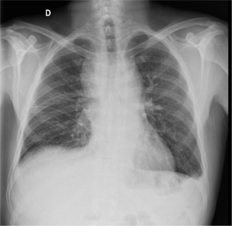 Acute descending necrotizing mediastinitis as a complication of a ...