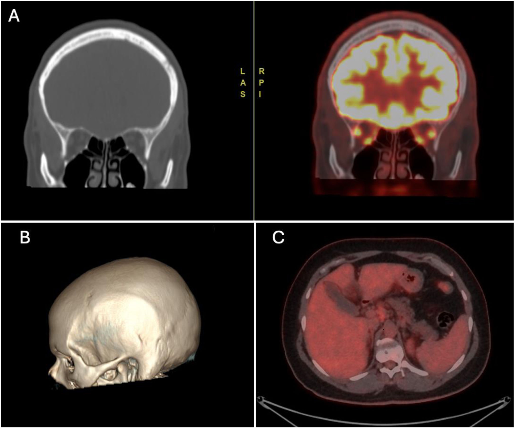 Tertiary syphilis with bone involvement and lymphadenopathy detected by ...