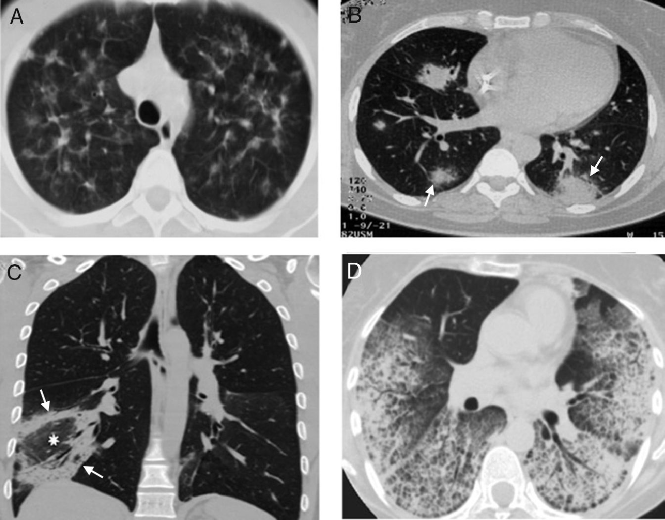Radiographic patterns in the diagnostic approach to organizing ...