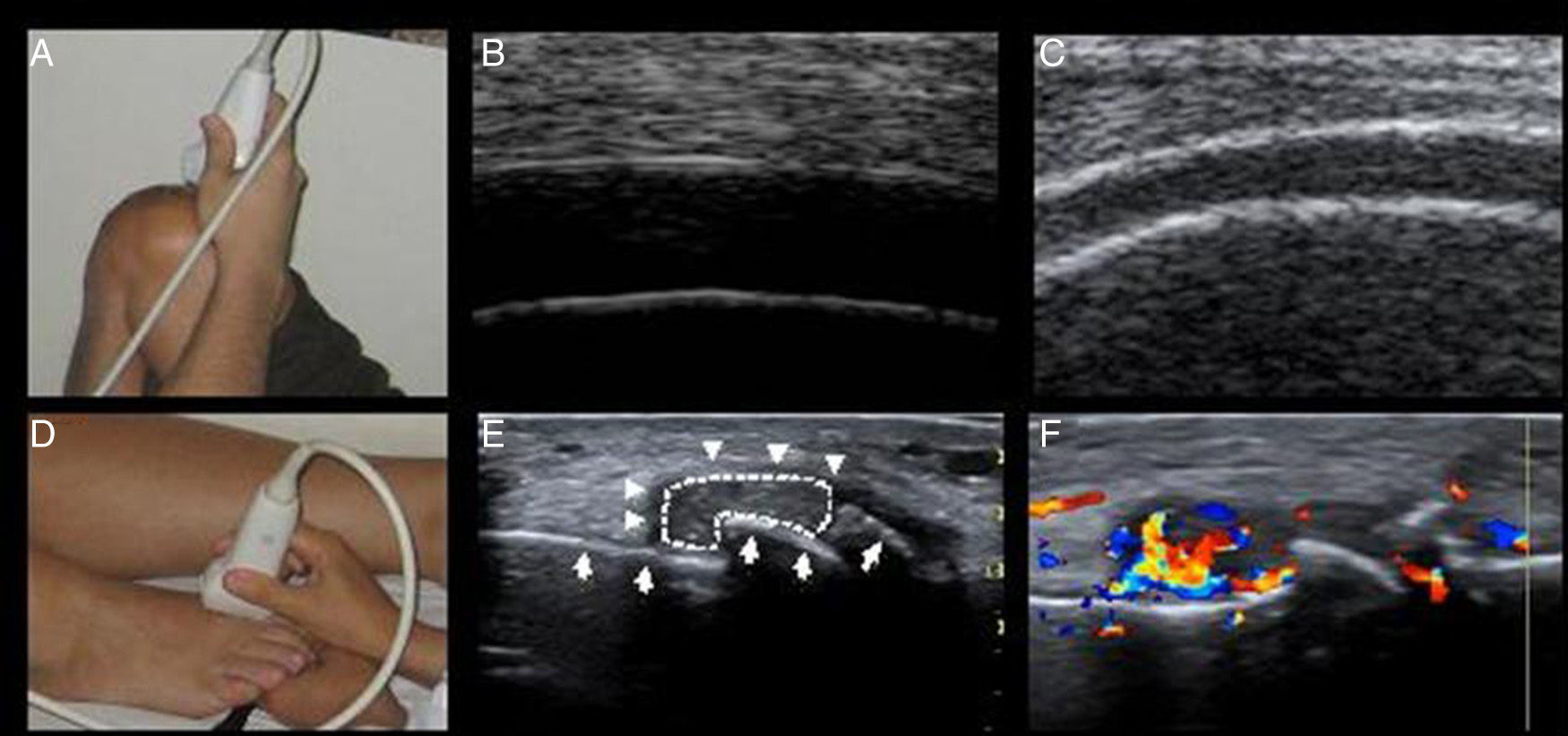 Ultrasound in the diagnosis of asymptomatic hyperuricemia and gout ...