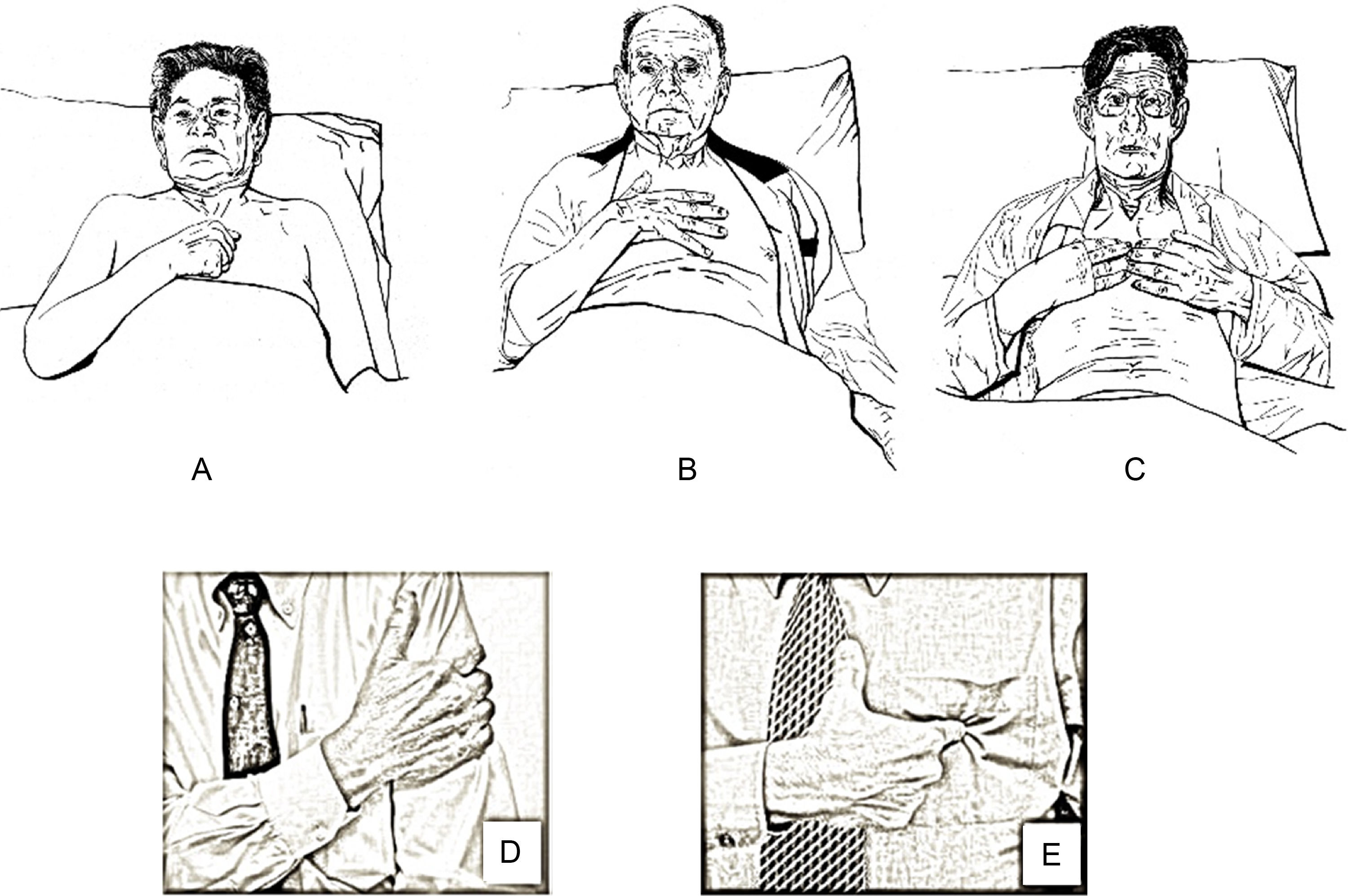 Diagnostic validity of hand gestures in chest pain of coronary origin ...