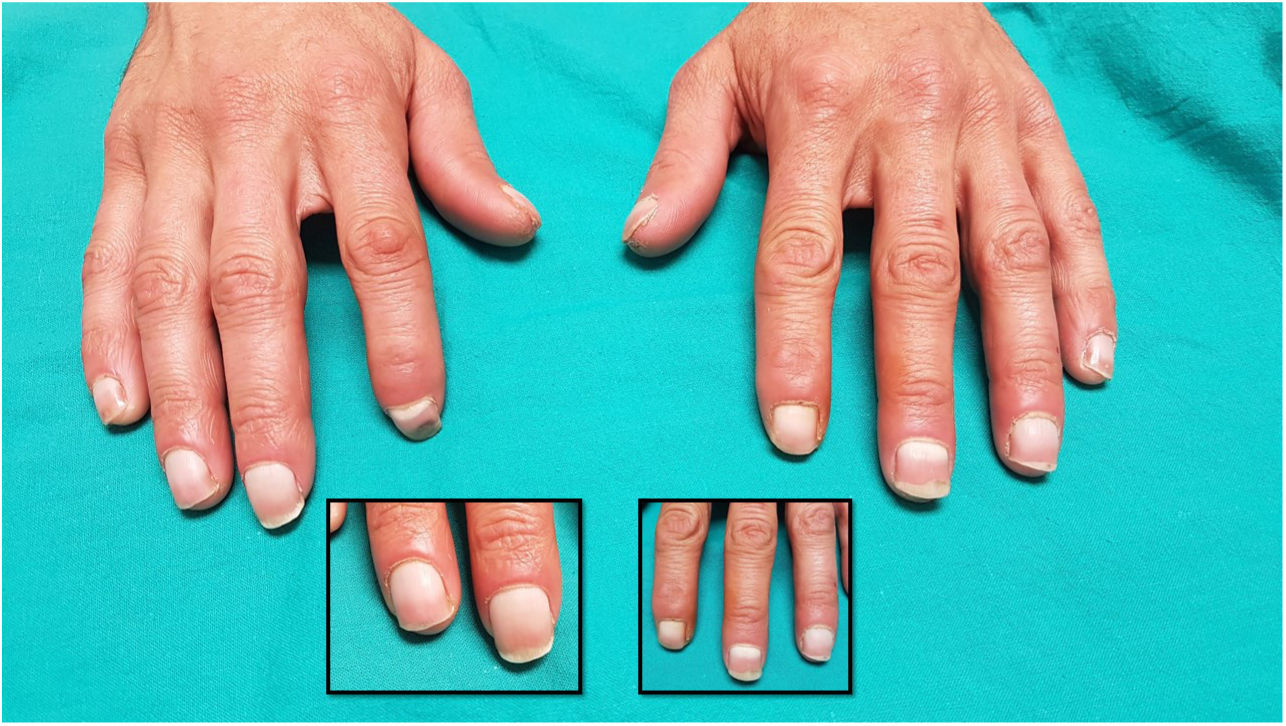 Terry’s nails as the first clinical sign of autoimmune hepatitis ...