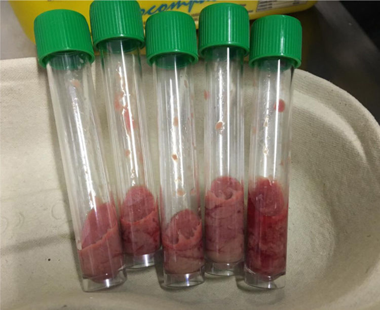 Liver abscess in «anchovy paste»; Amebiasis alert | Revista Clínica ...