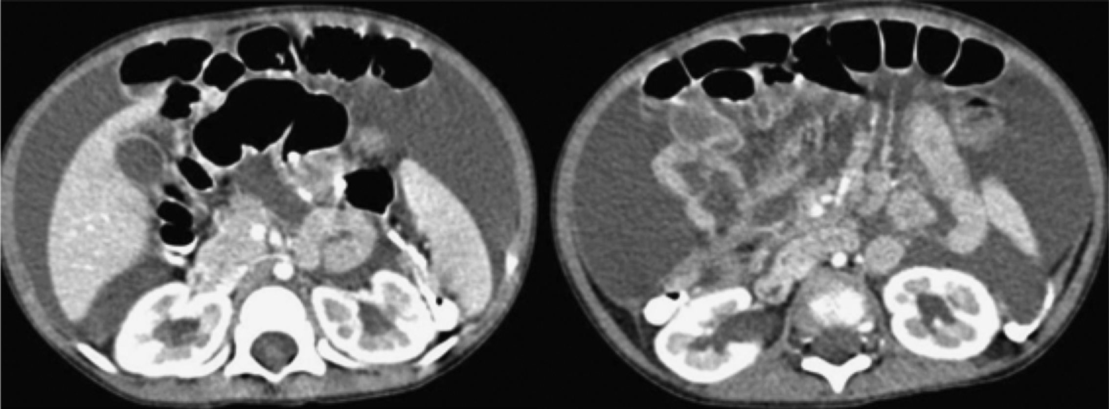 Idiopathic sclerosing mesenteritis in the pediatric patient: A case ...
