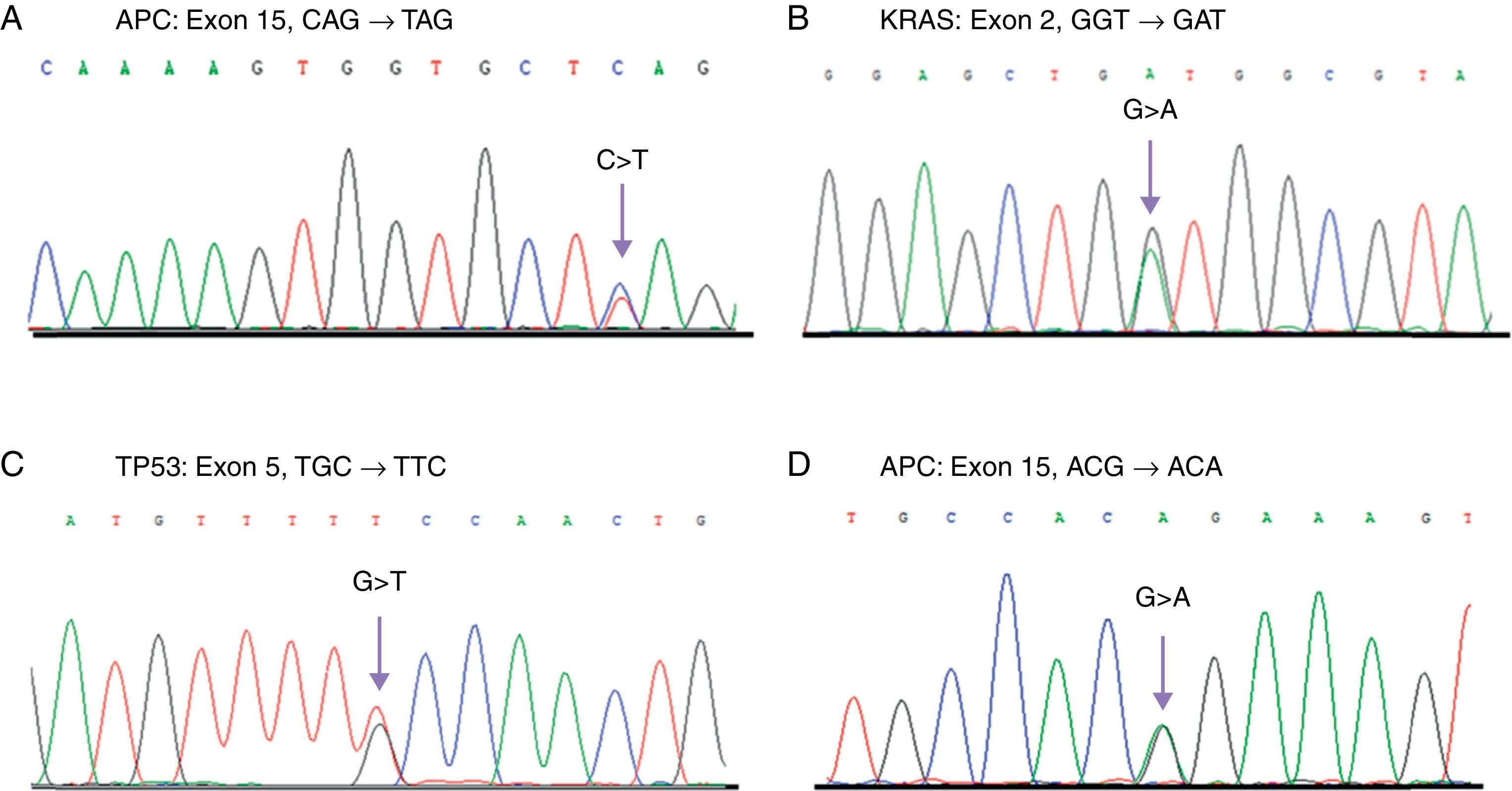 Genetic analysis in APC, KRAS, and TP53 in patients with stomach and ...