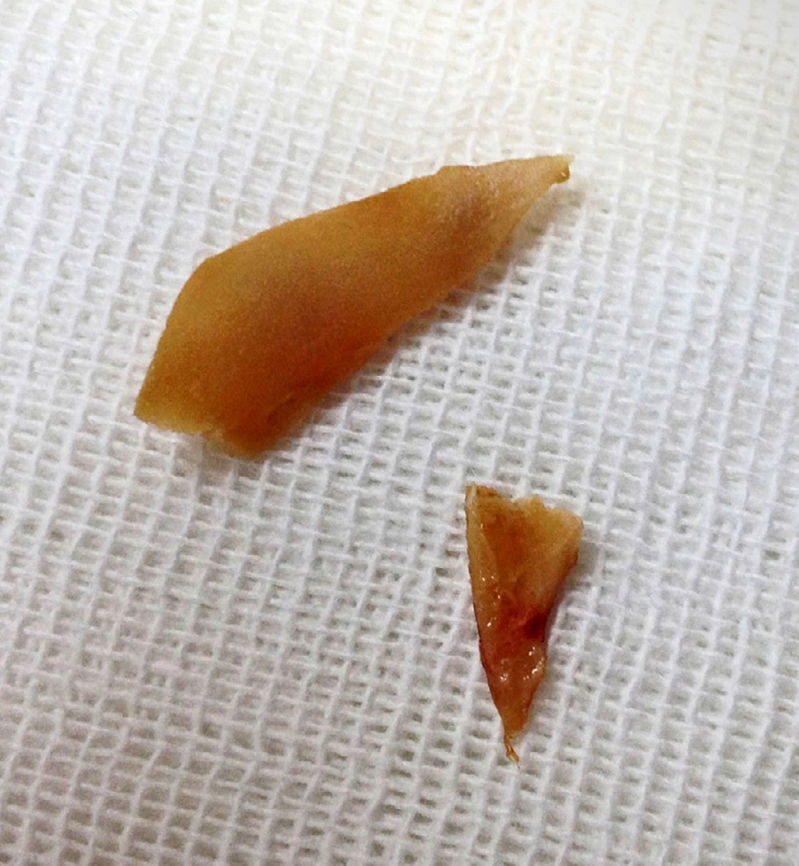 Chicken bone as swallowed foreign body | Revista de Gastroenterología ...