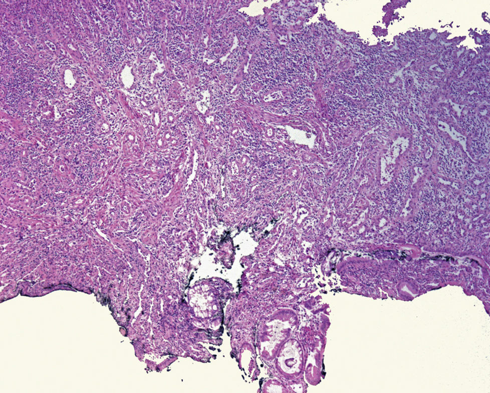 Inflammatory fibroid polyp of the gastrointestinal tract: 10 years of ...