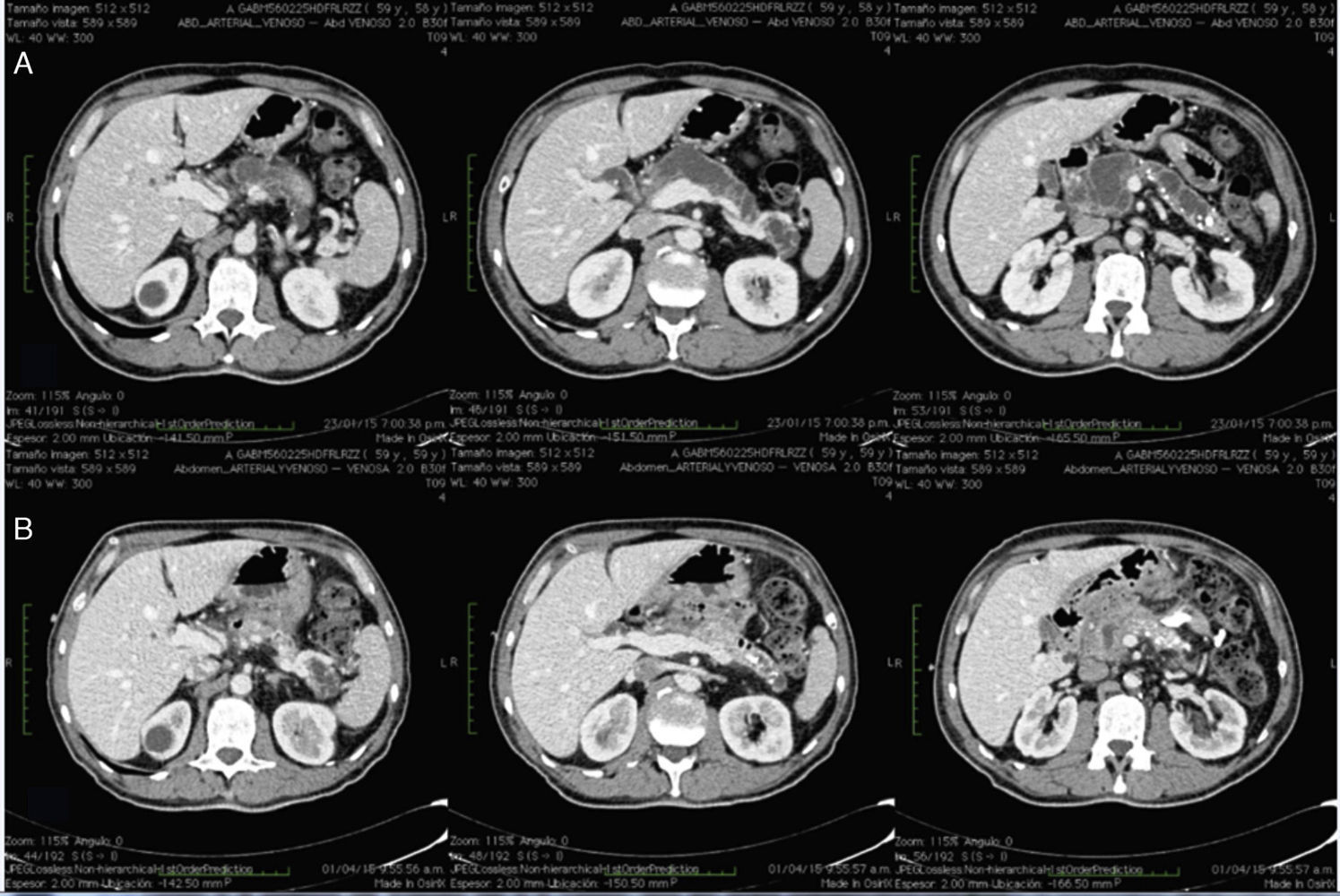 Total laparoscopic pancreaticojejunal anastomosis (modified Puestow ...