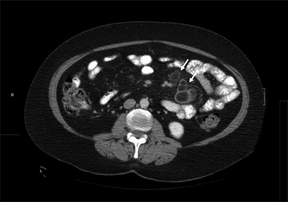 Cavitating mesenteric lymph node syndrome: An uncommon complication of ...