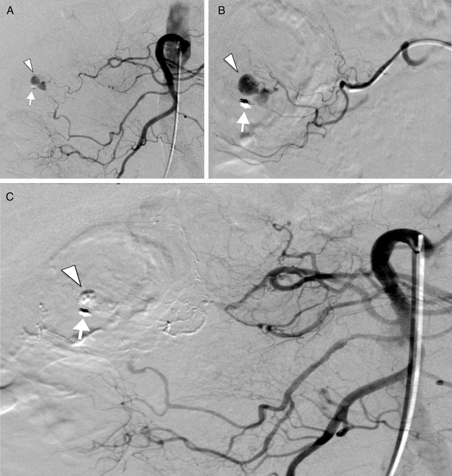 Acute intestinal bleeding after endoscopic polypectomy: Super-selective ...