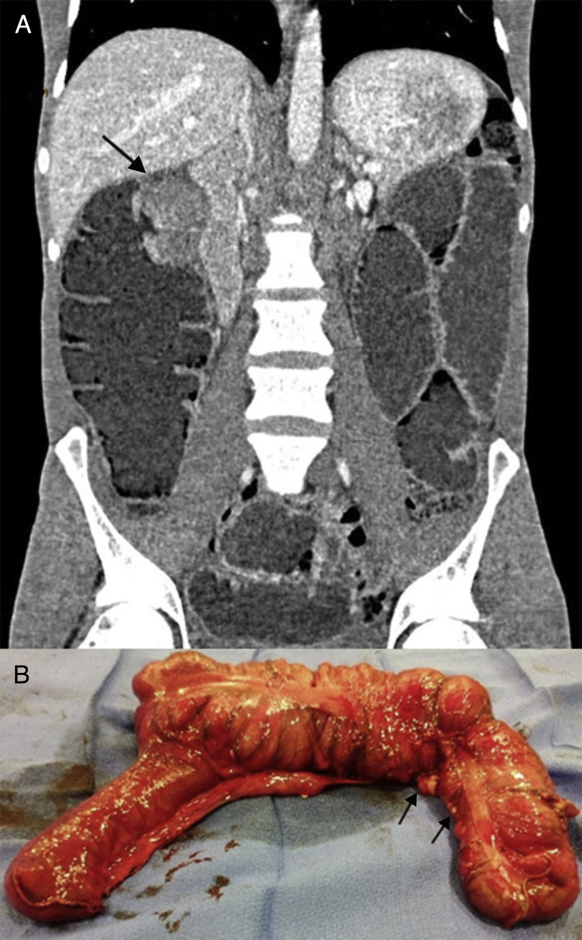 Primary signet ring cell carcinoma of the colon: A rare condition with ...