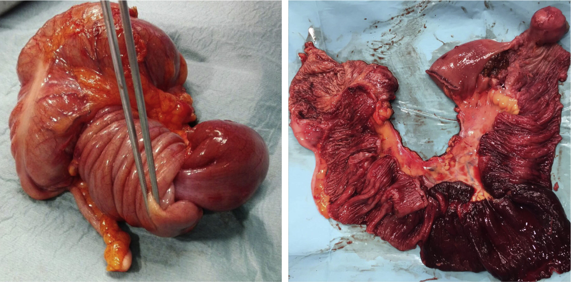 intussusception stool like