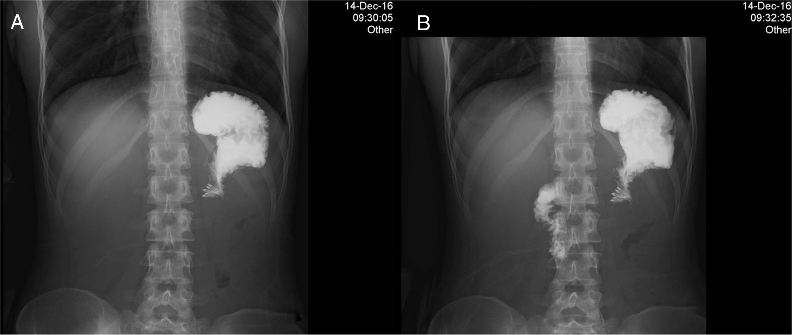 Gastric per-oral endoscopic pyloromyotomy in the treatment of ...