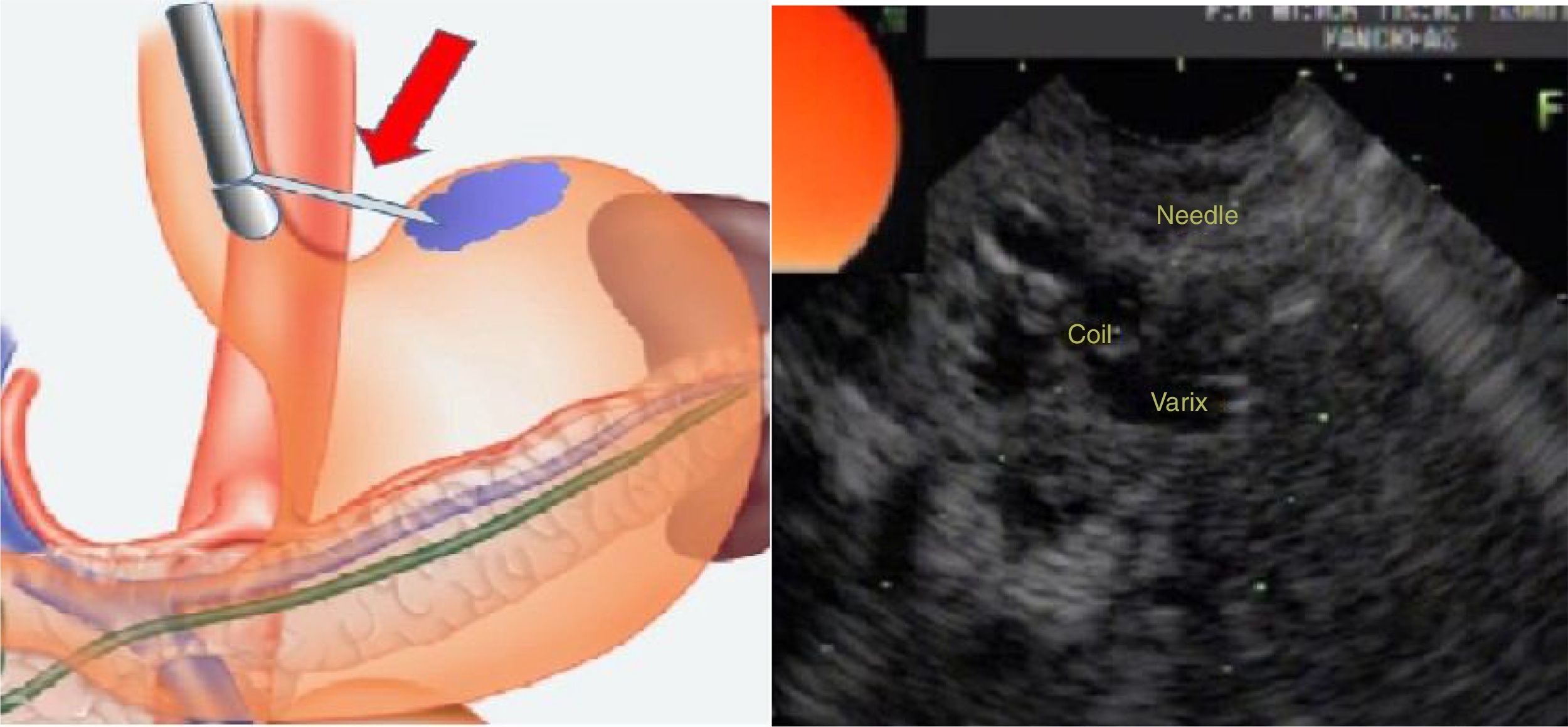 mesocaval shunt embolization
