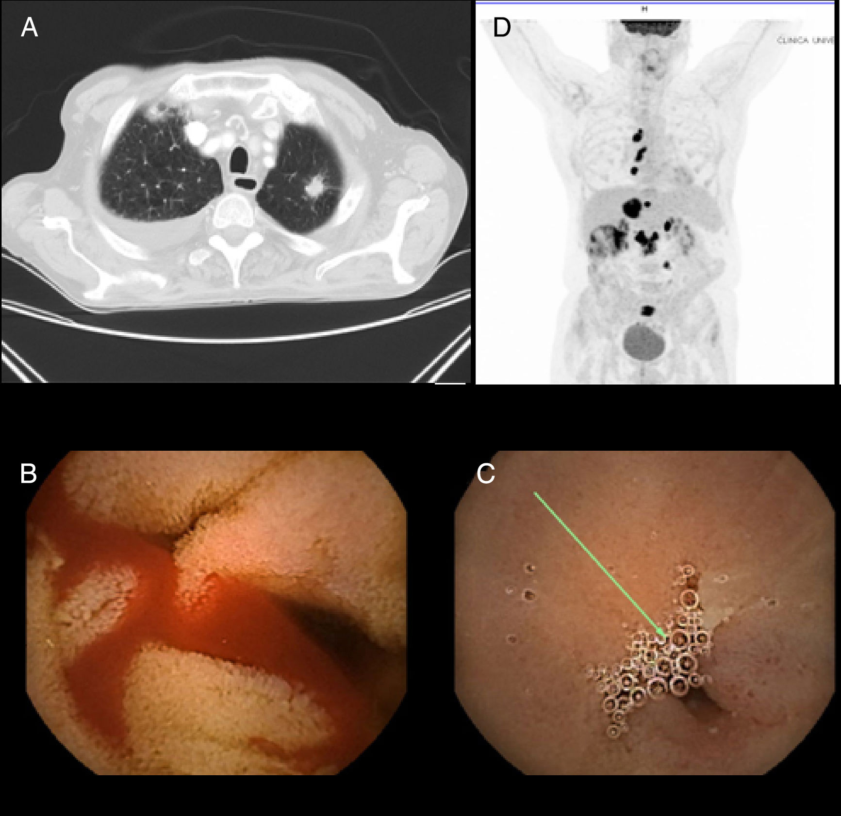 primary lung lesion